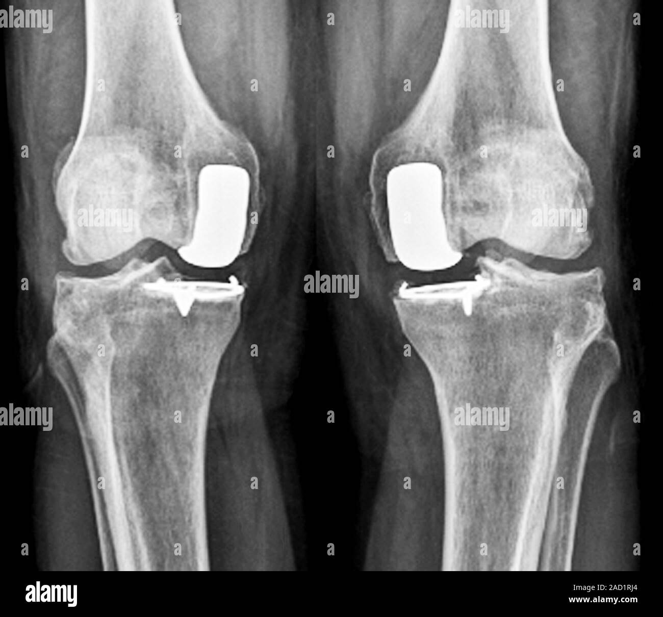 Partial knee replacement. X-ray of the knees of a 58-year-old patient ...