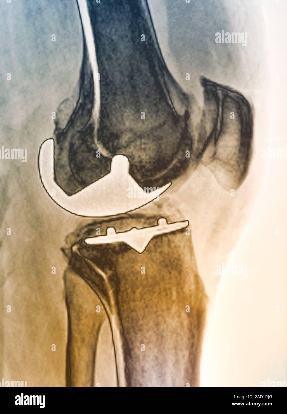 Partial knee replacement. Coloured X-ray of the left knee of a 58-year ...