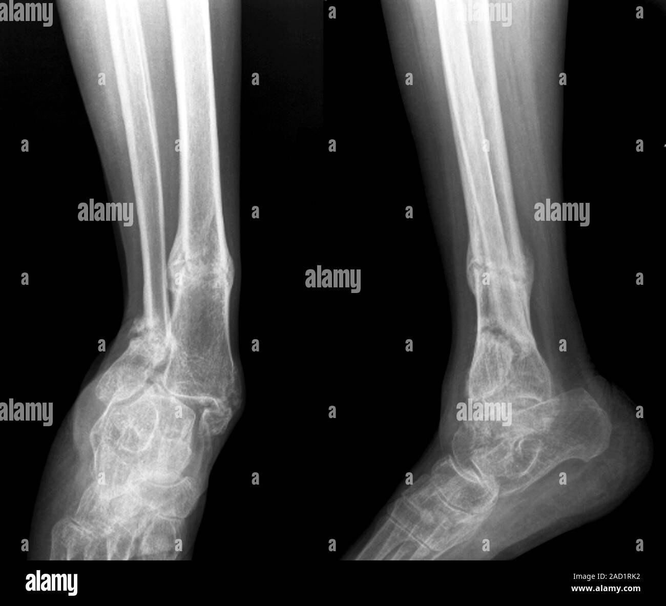 Broken leg. X-rays of the lower right leg of a 61-year-old patient with ...