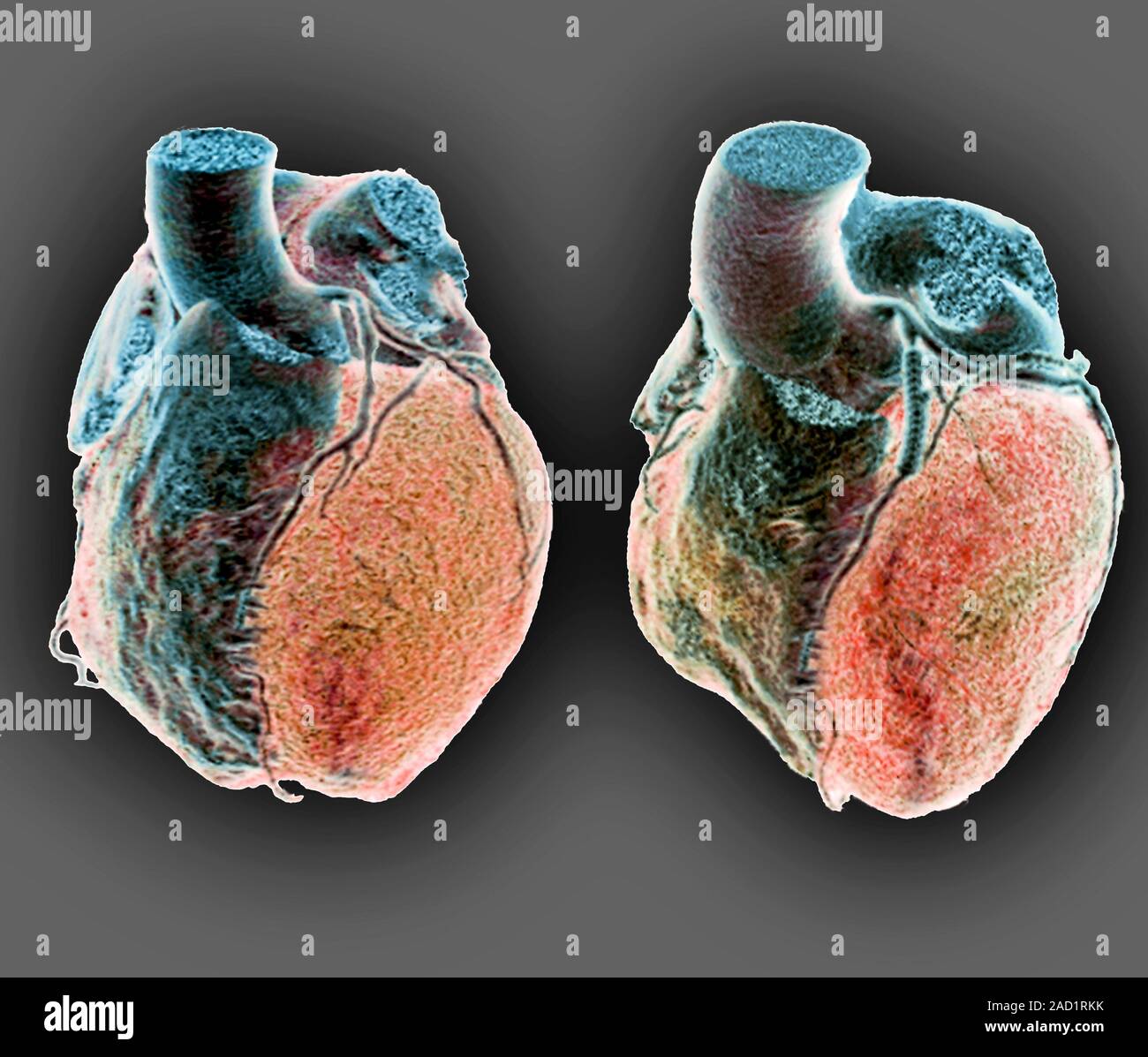 Coronary stent. 3D computed tomography (CT) scans of the heart of a 58 ...