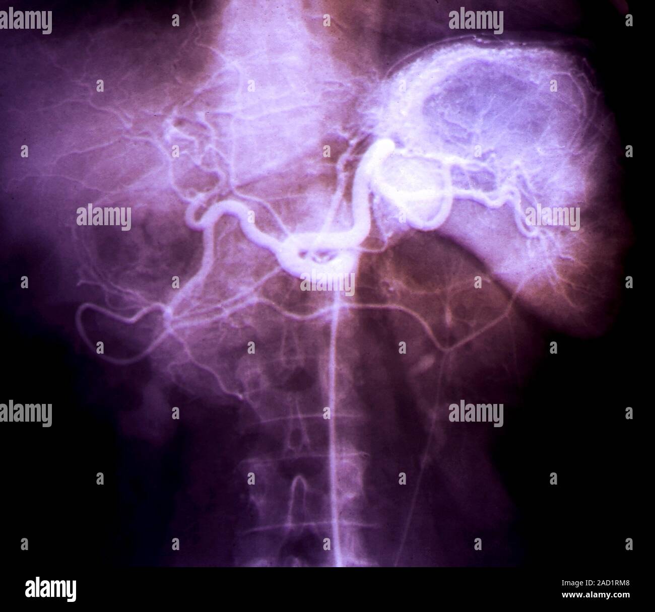 Spleen abscess. Coloured angiogram of a section through the abdomen of ...