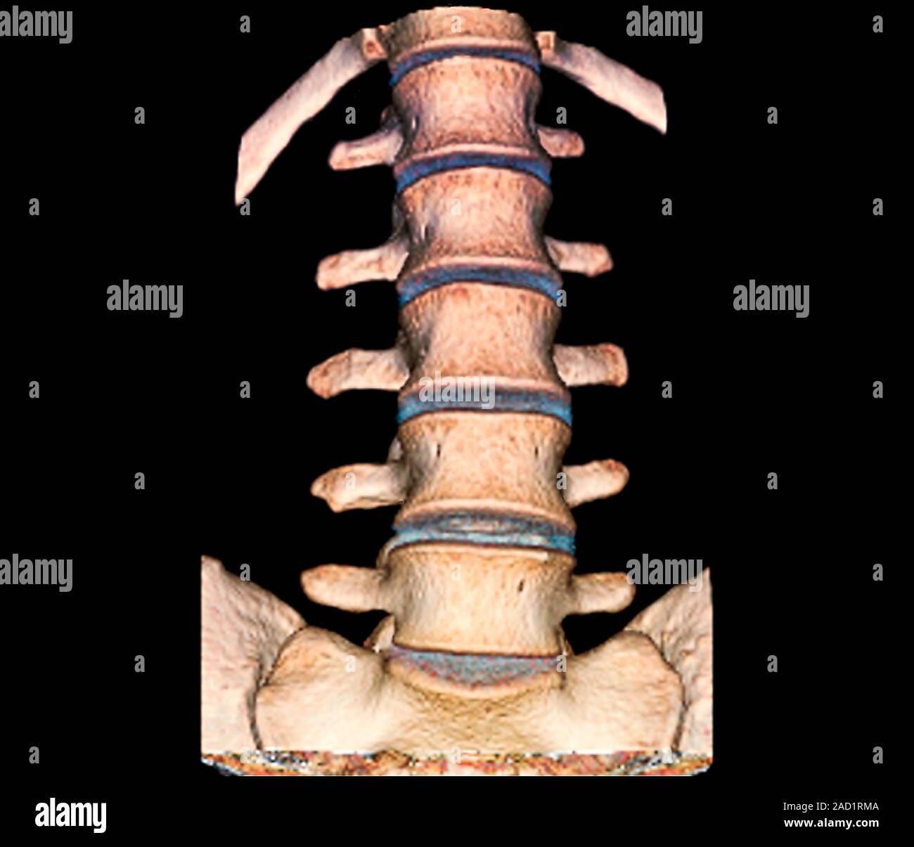 Normal spine. Coloured 3D computed tomography (CT) scan of the rear of ...