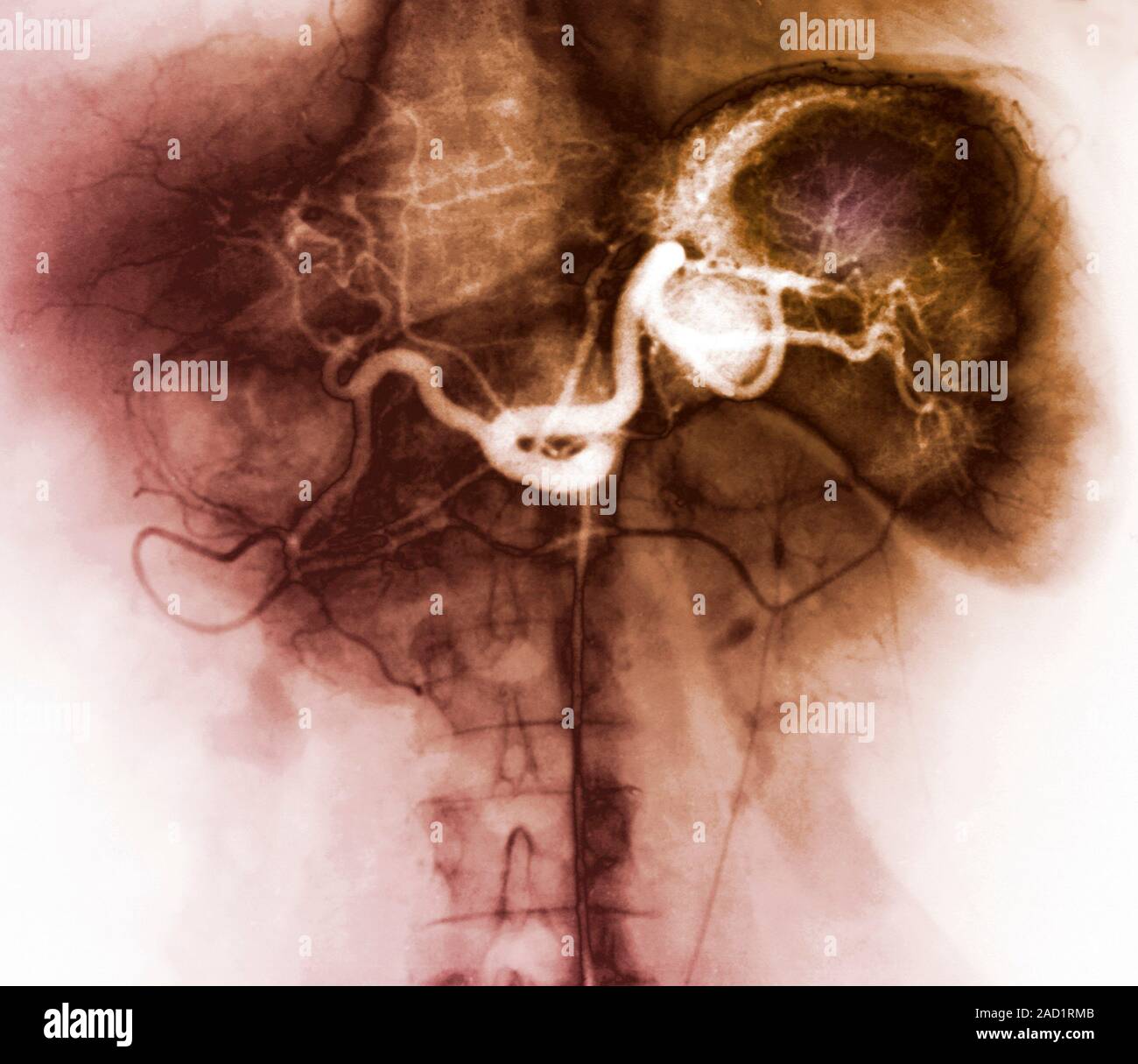 Spleen abscess. Coloured angiogram of a section through the abdomen of ...