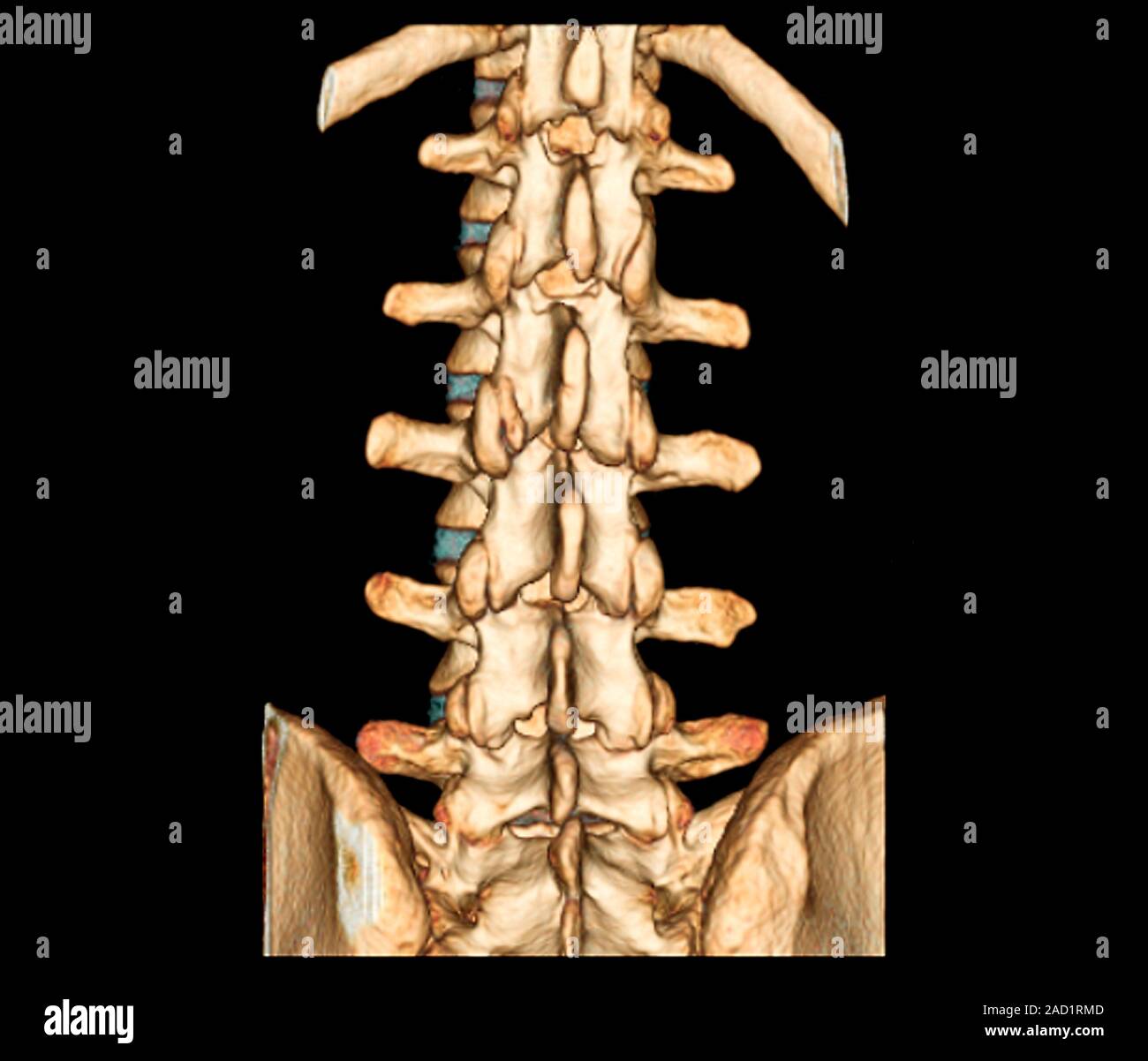 Normal spine. Coloured 3D computed tomography (CT) scan of the front of ...
