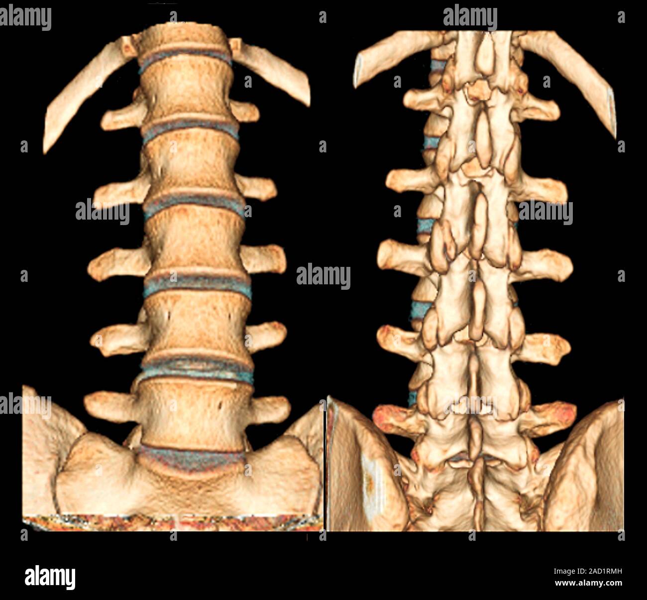 Normal spine. Coloured 3D computed tomography (CT) scans of the front ...