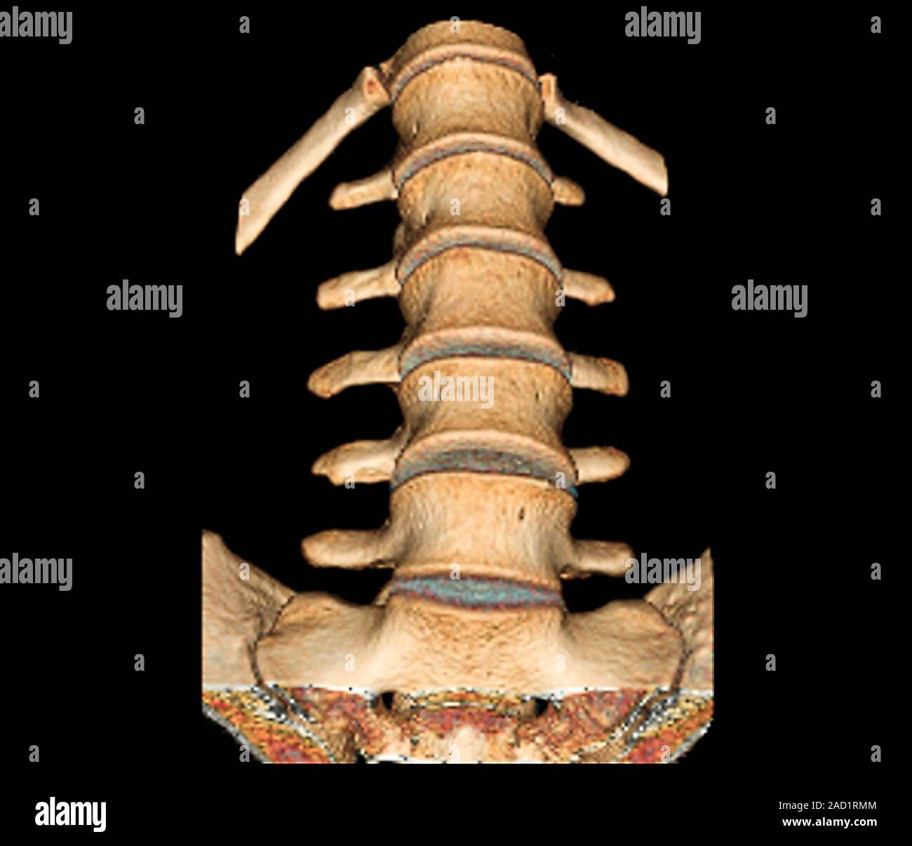 Normal spine. Coloured 3D computed tomography (CT) scan of the rear of ...