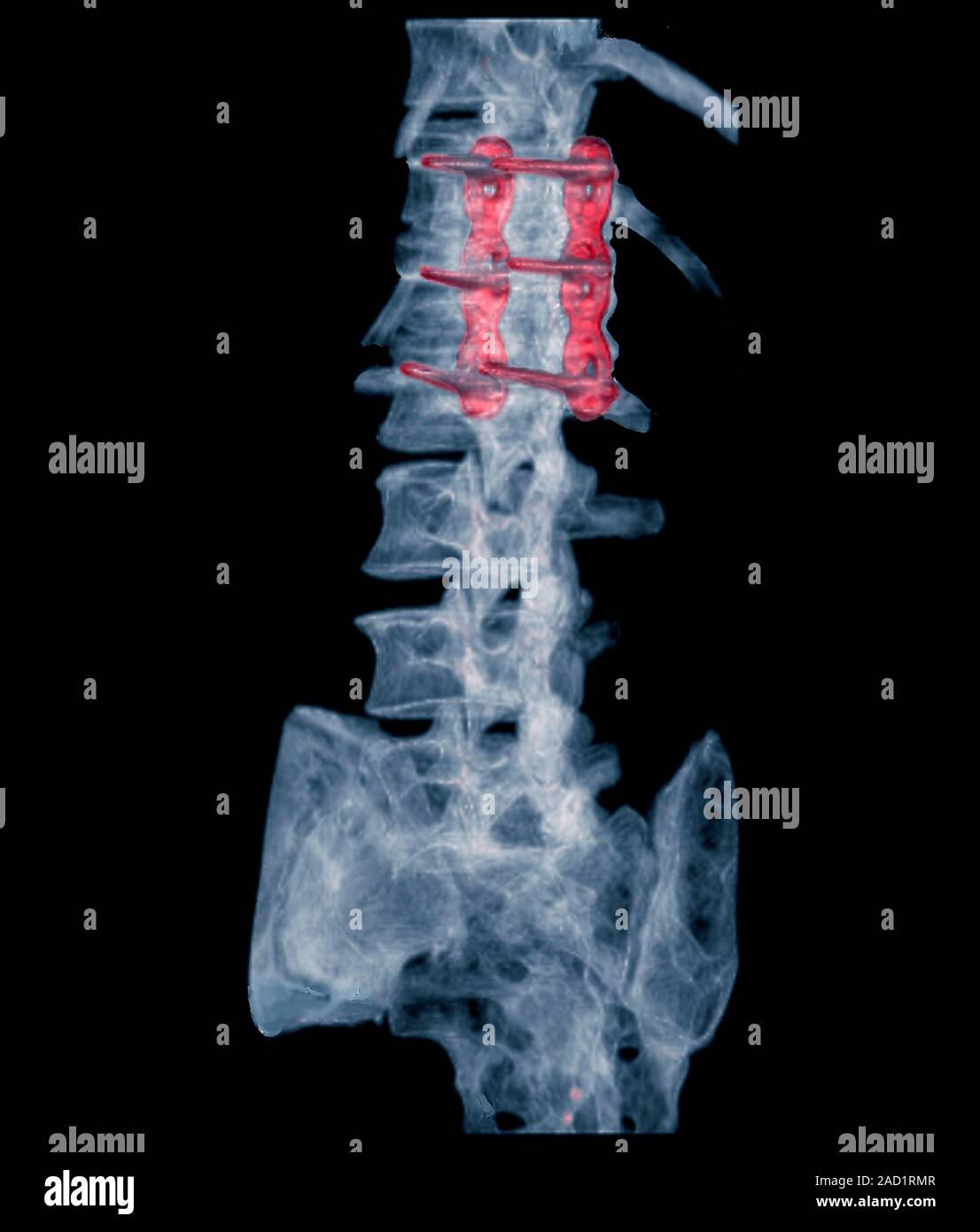 Pinned spinal fracture. Coloured 3D computed tomography (CT) scan of ...