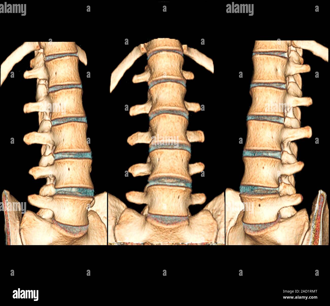 Normal spine. Coloured 3D computed tomography (CT) scans of the rear ...