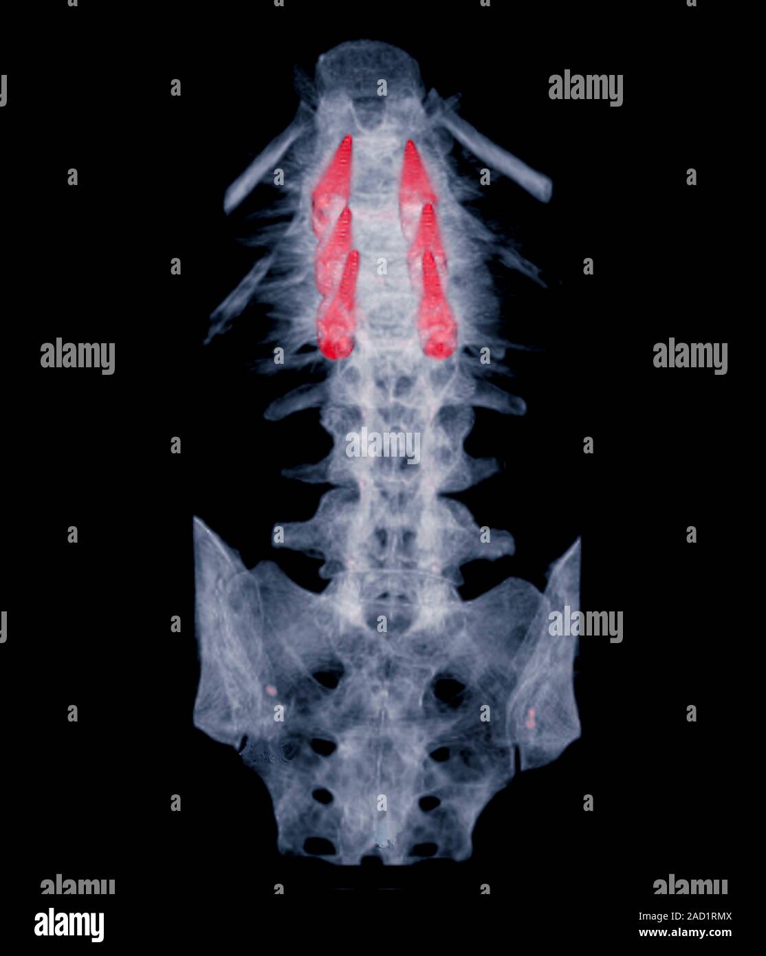 Pinned spinal fracture. Coloured frontal 3D computed tomography (CT ...