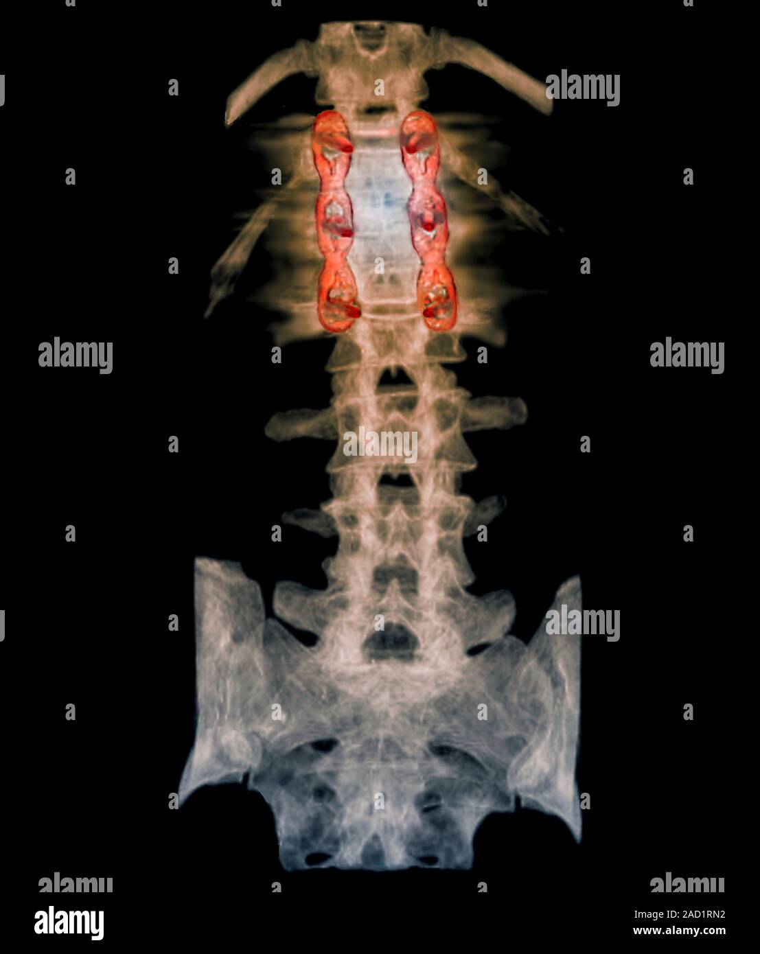 Pinned spinal fracture. Coloured frontal 3D computed tomography (CT ...