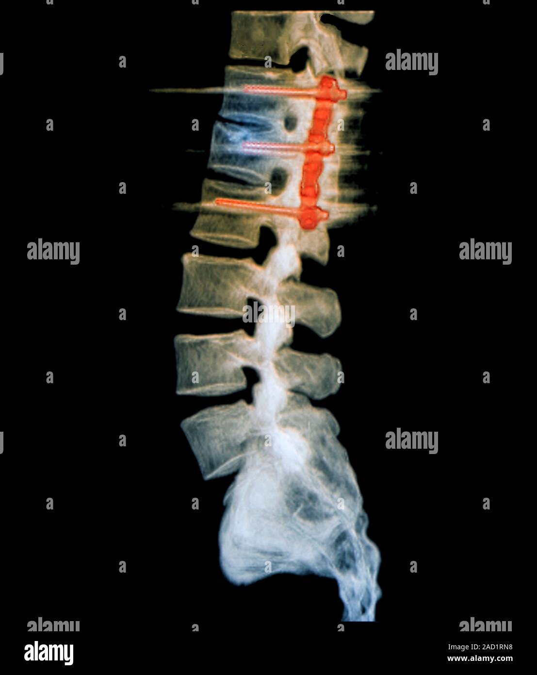 Pinned spinal fracture. Coloured 3D computed tomography (CT) scan of the lumbar (lower back ...