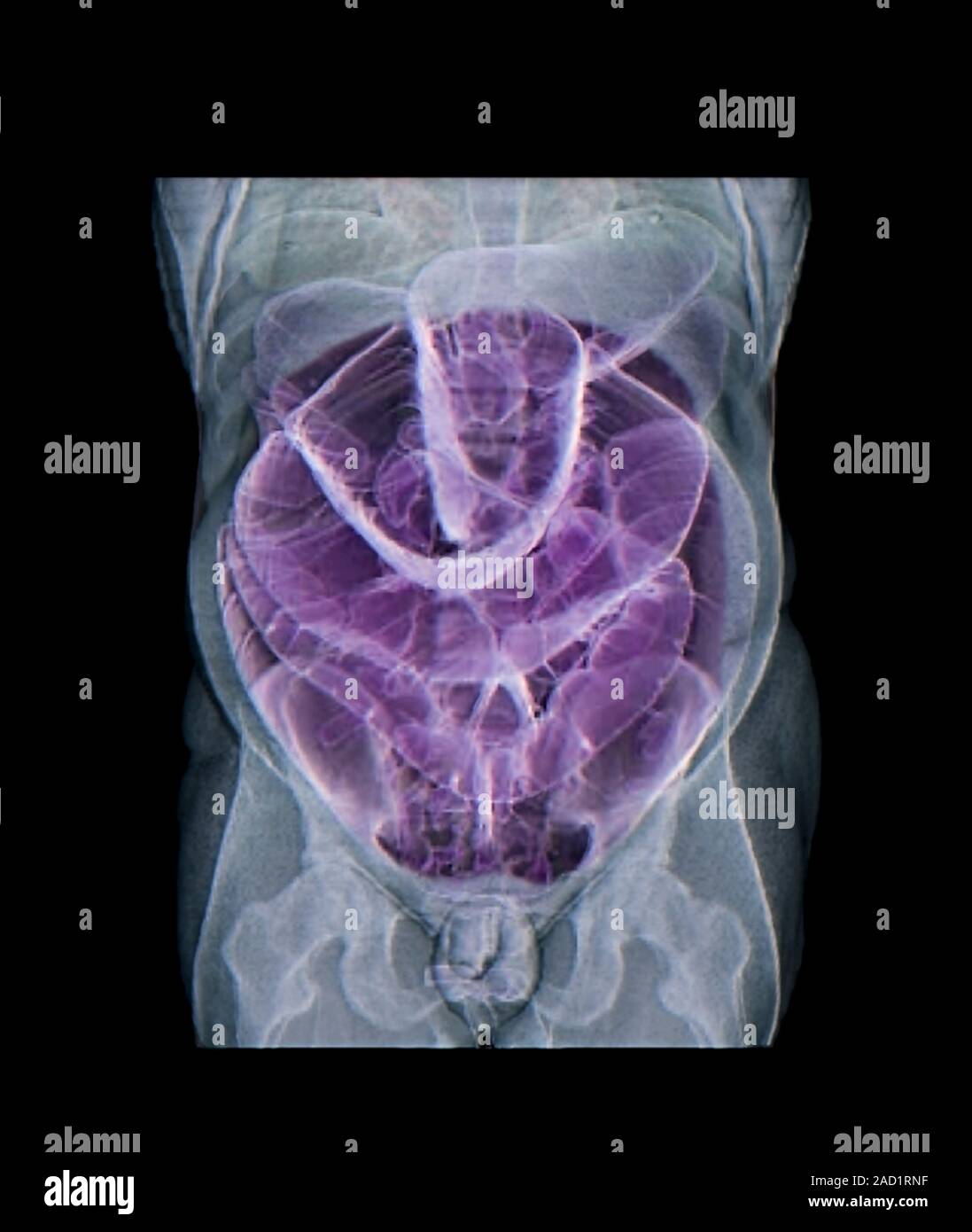 Abnormally large intestine. Coloured 3D computed tomography (CT) scan ...