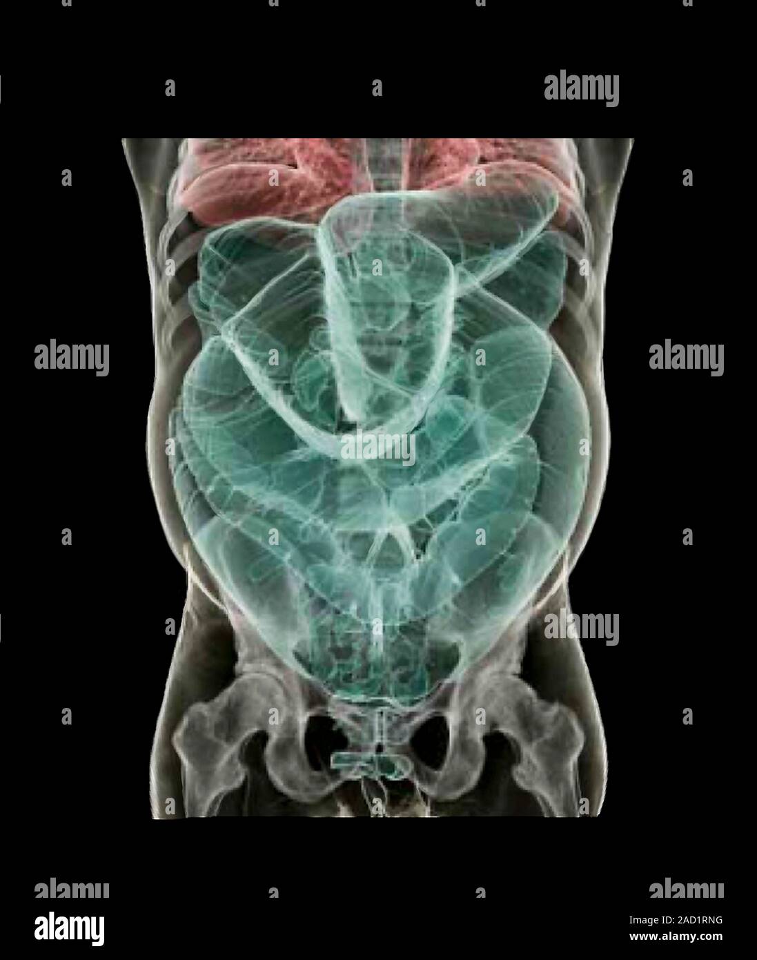 Abnormally large intestine. Coloured 3D computed tomography (CT) scan ...