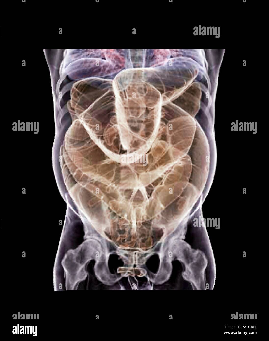 Abnormally large intestine. Coloured 3D computed tomography (CT) scan ...