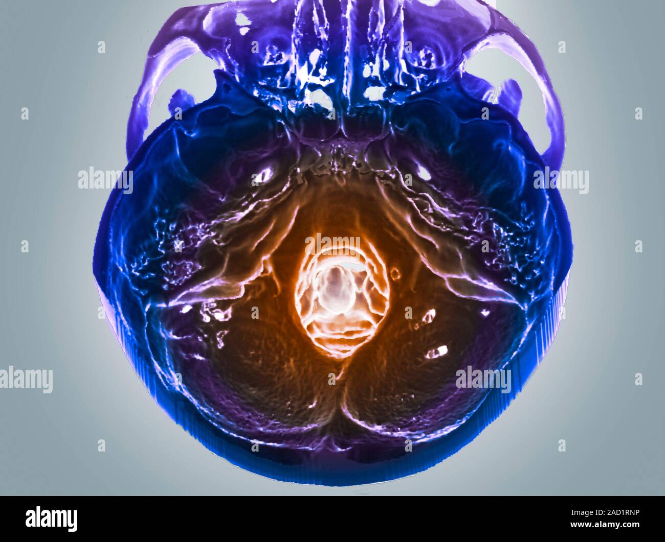 Normal skull. 3D computed tomography (CT) scan the base of the skull of ...
