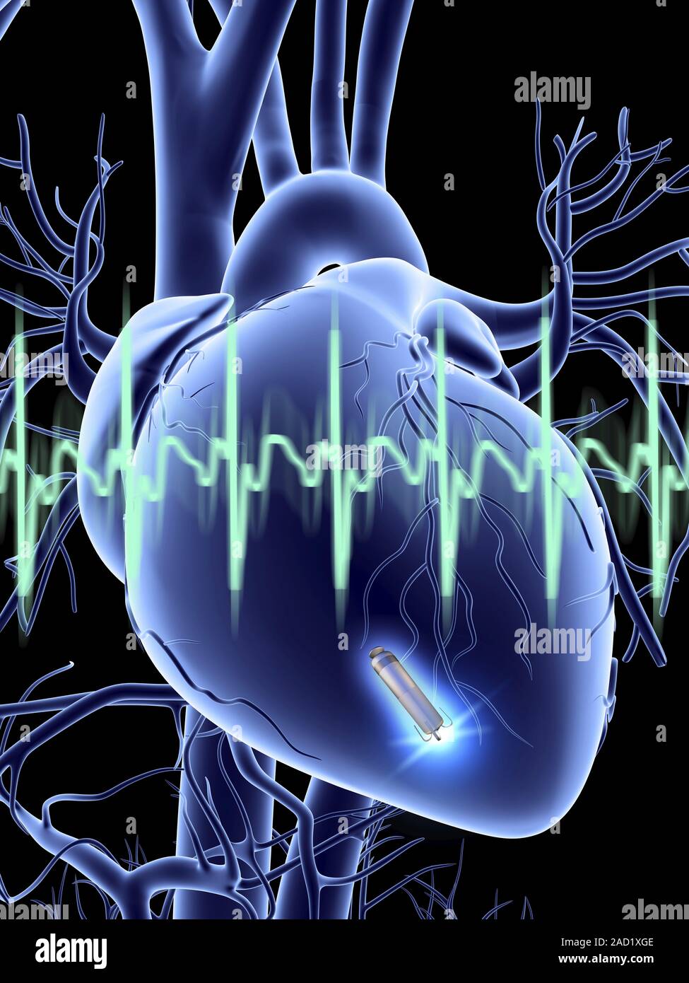 Computer artwork showing a leadless cardiac pacemaker in a human heart ...