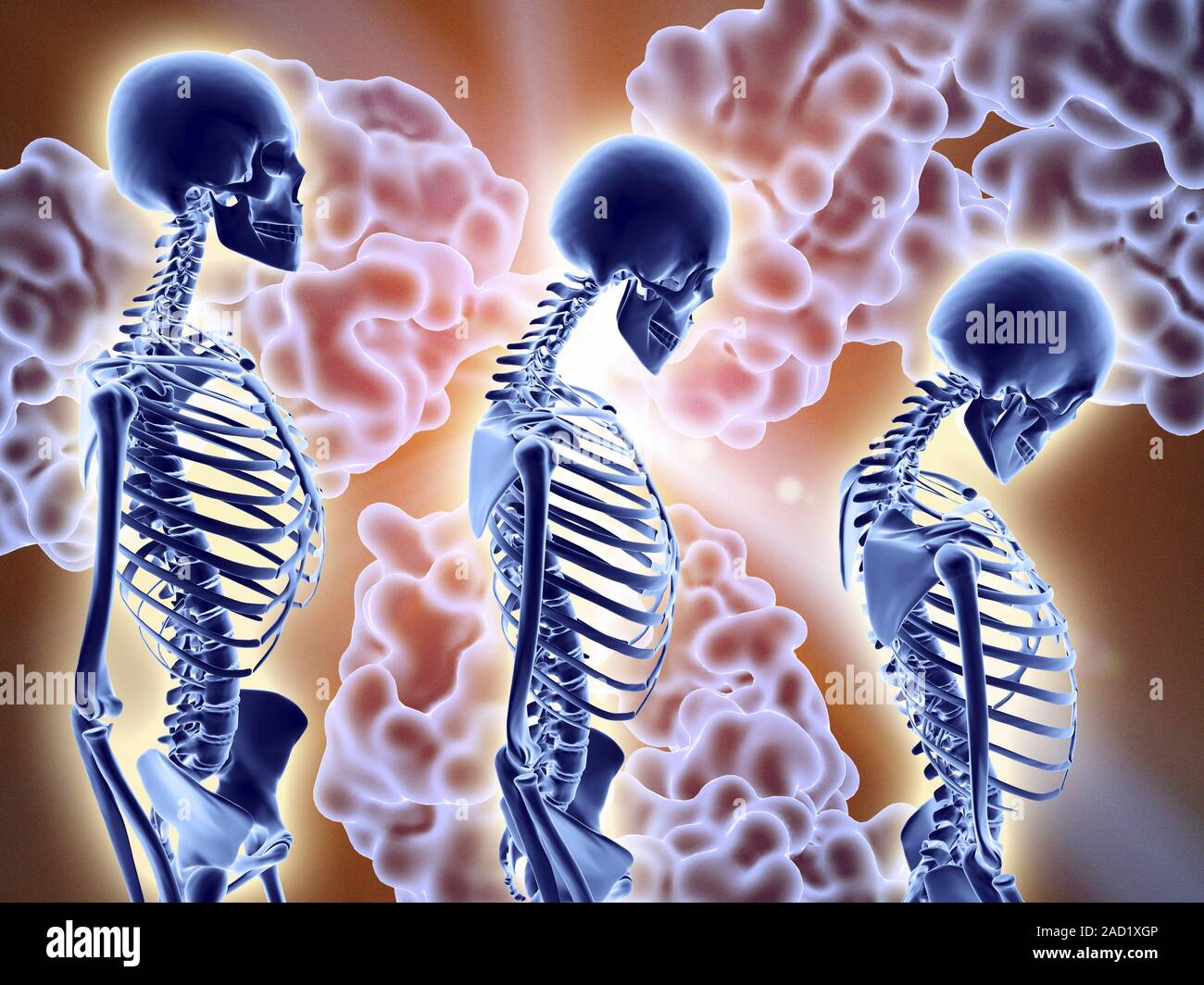 Osteoporosis. Computer artwork of a human female skeleton degenerating ...