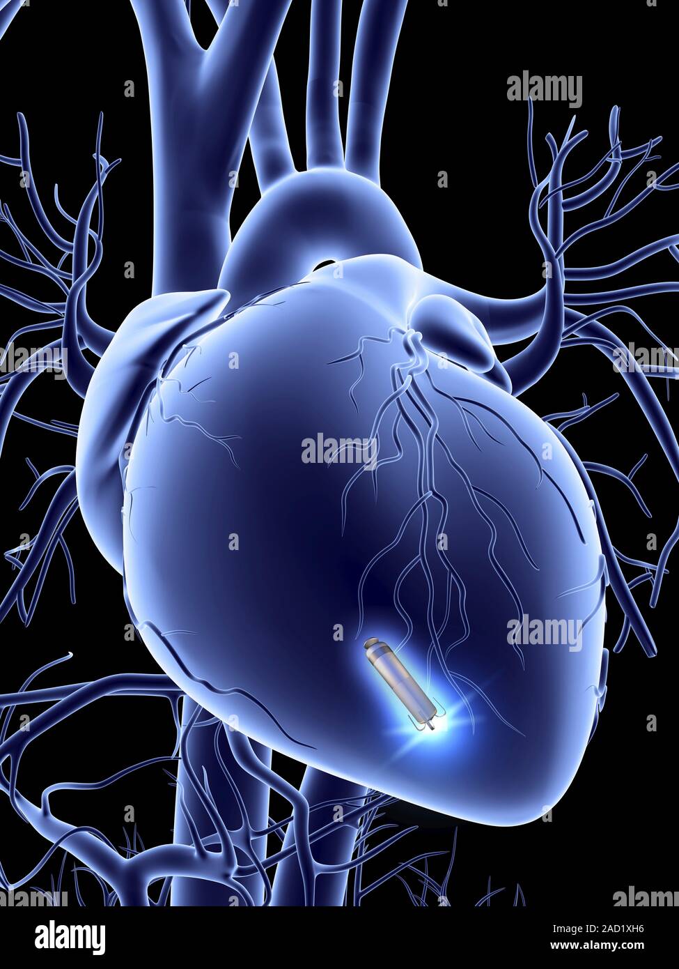 Computer artwork showing a leadless cardiac pacemaker in a human heart ...
