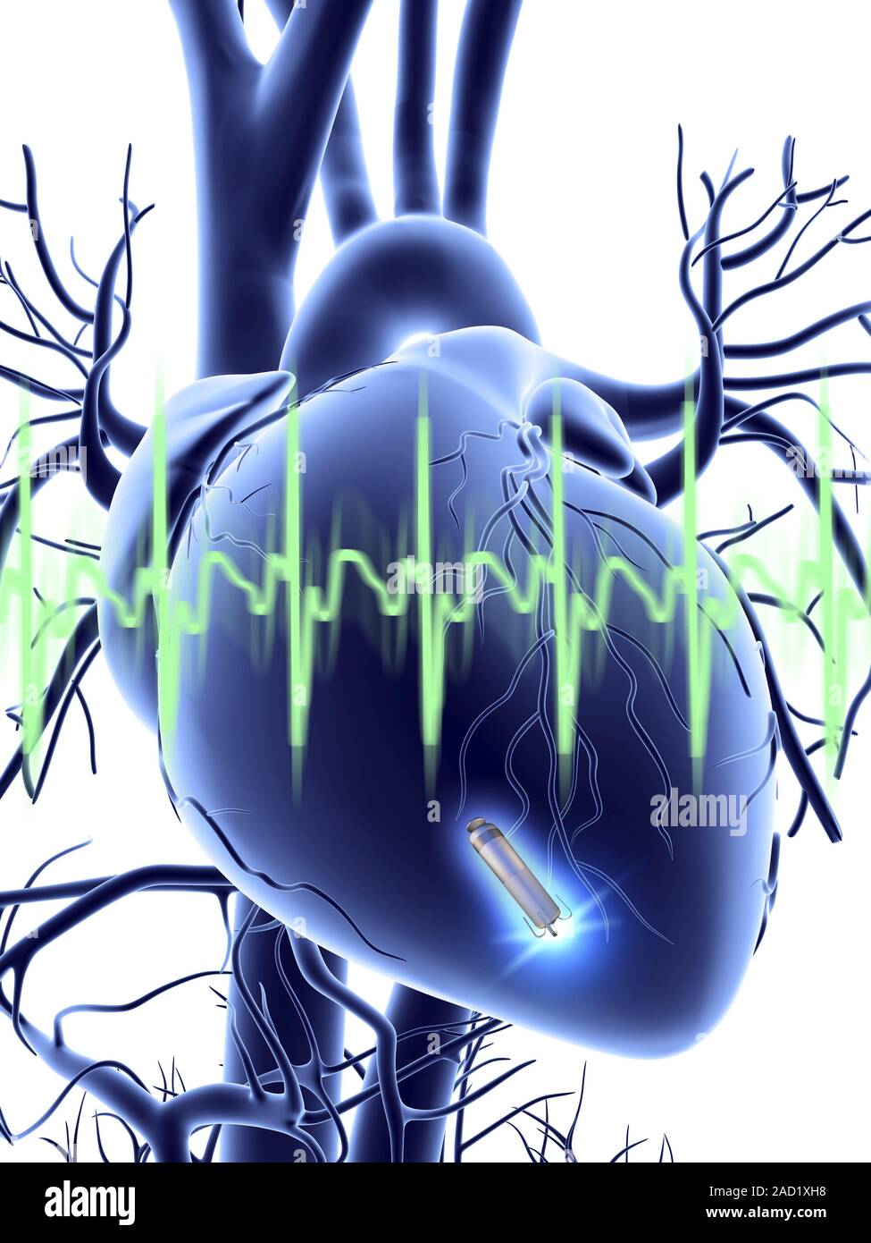 Computer artwork showing a leadless cardiac pacemaker in a human heart ...