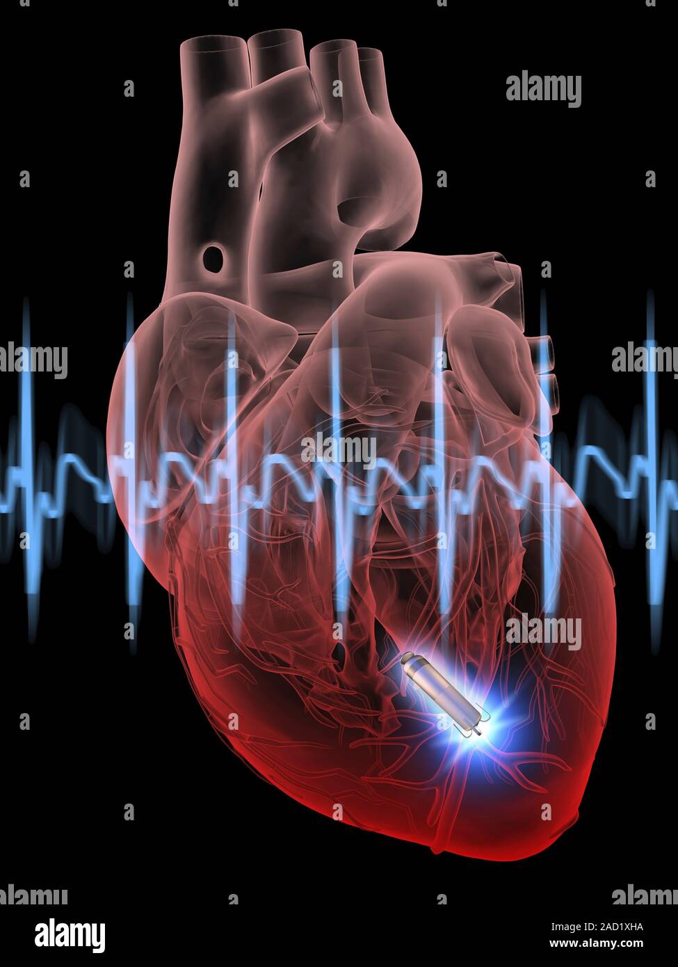 Computer artwork showing a leadless cardiac pacemaker in a human heart ...