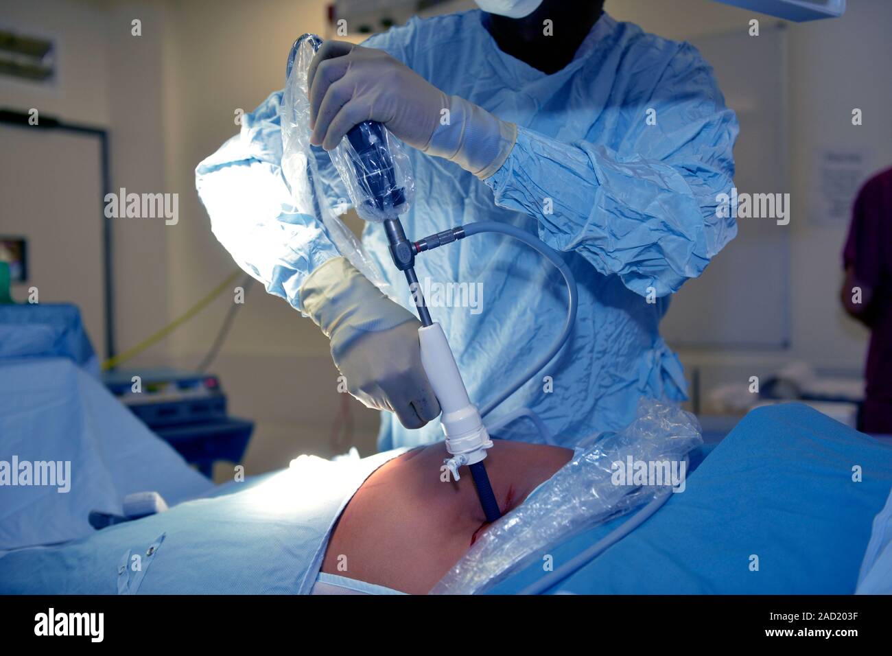 Gastric bypass surgery. Surgeon using endoscopic equipment during laparoscopic gastric bypass ...