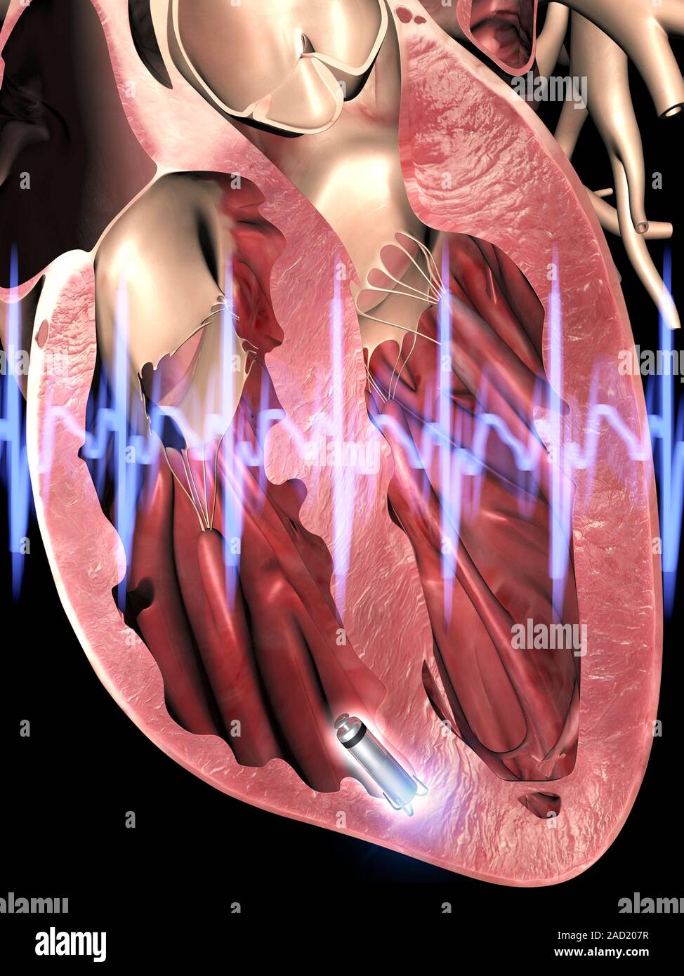 Computer artwork showing a leadless pacemaker in an anterior cut ...