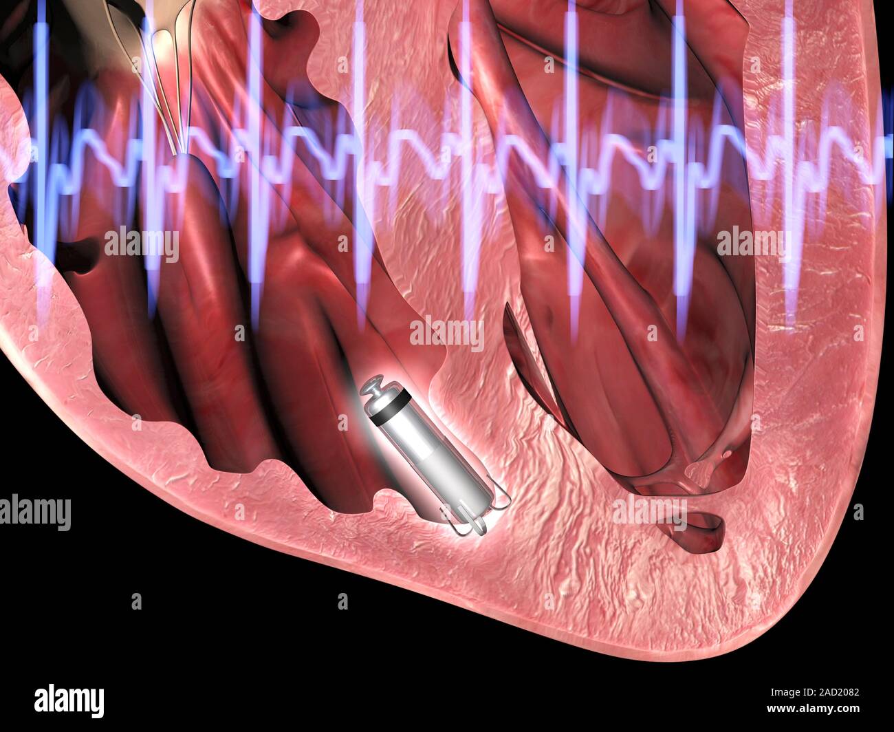 Computer artwork showing a leadless pacemaker in an anterior cut ...