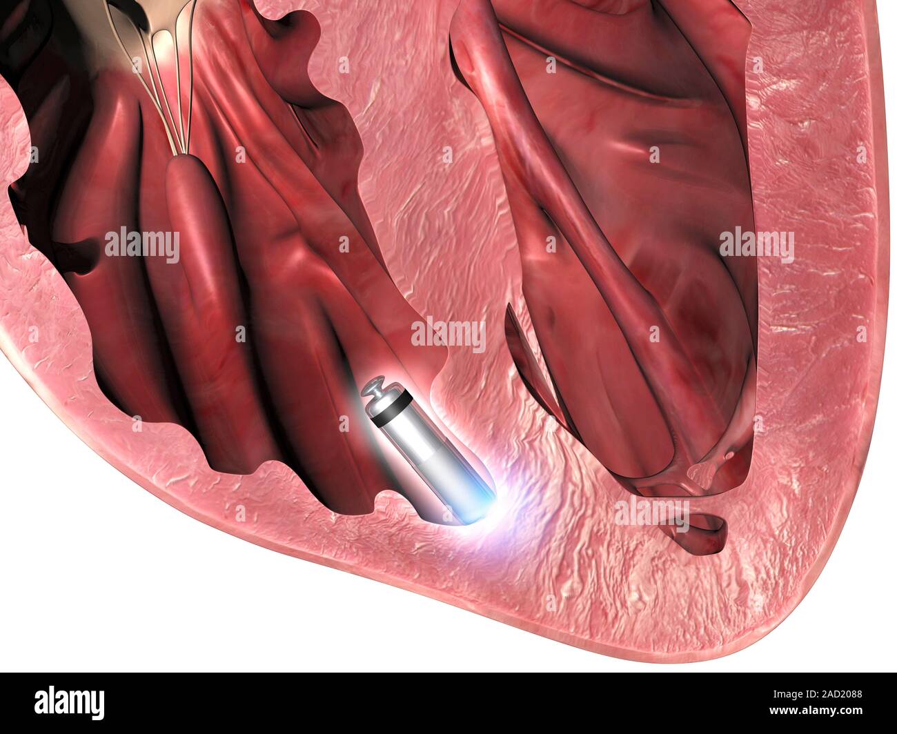 Computer artwork showing a leadless pacemaker in an anterior cut ...