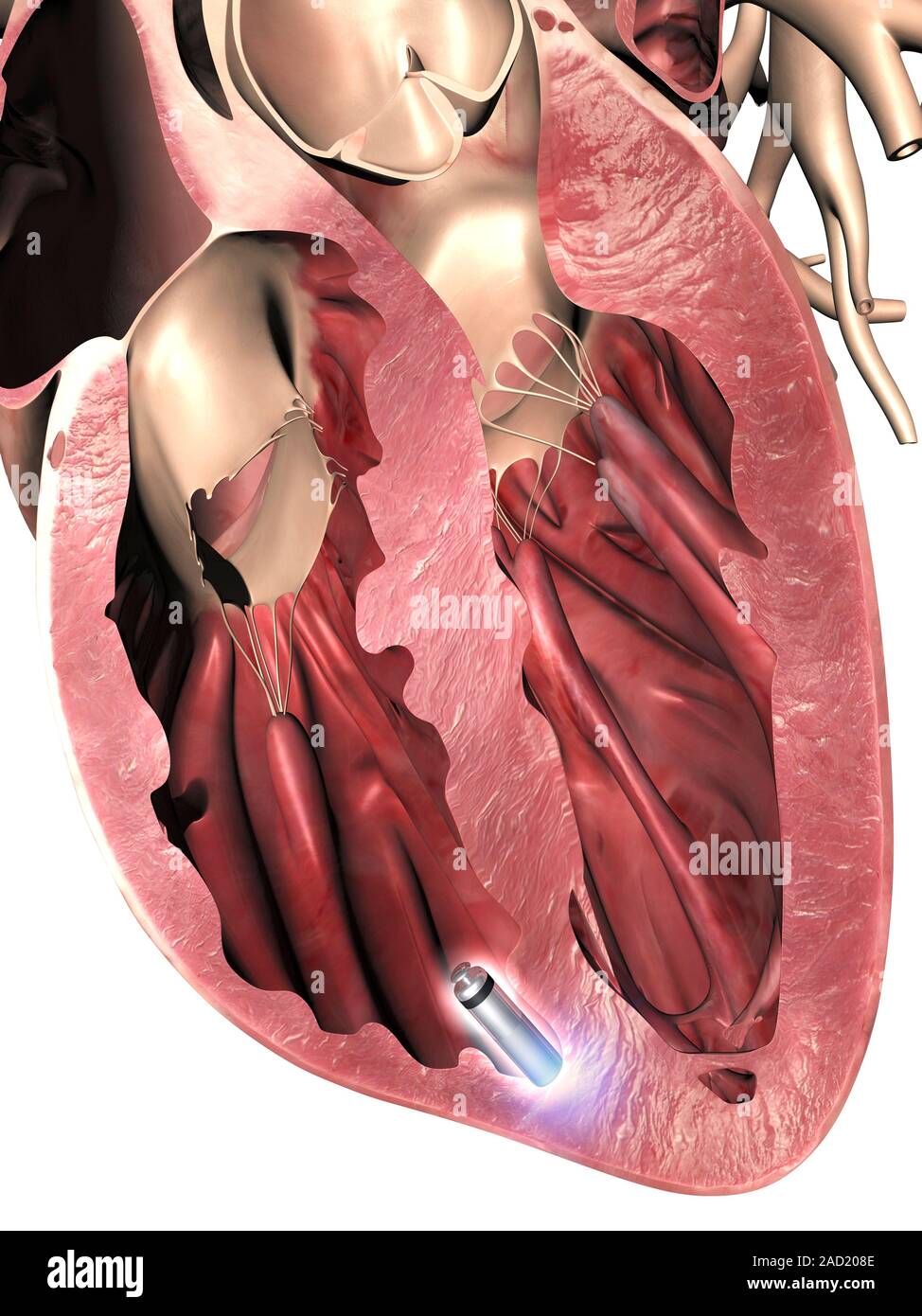 Computer artwork showing a leadless pacemaker in an anterior cut ...