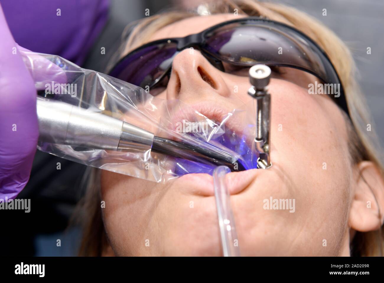 Dental filling. A woman undergoing dental treatment to fill a decayed ...