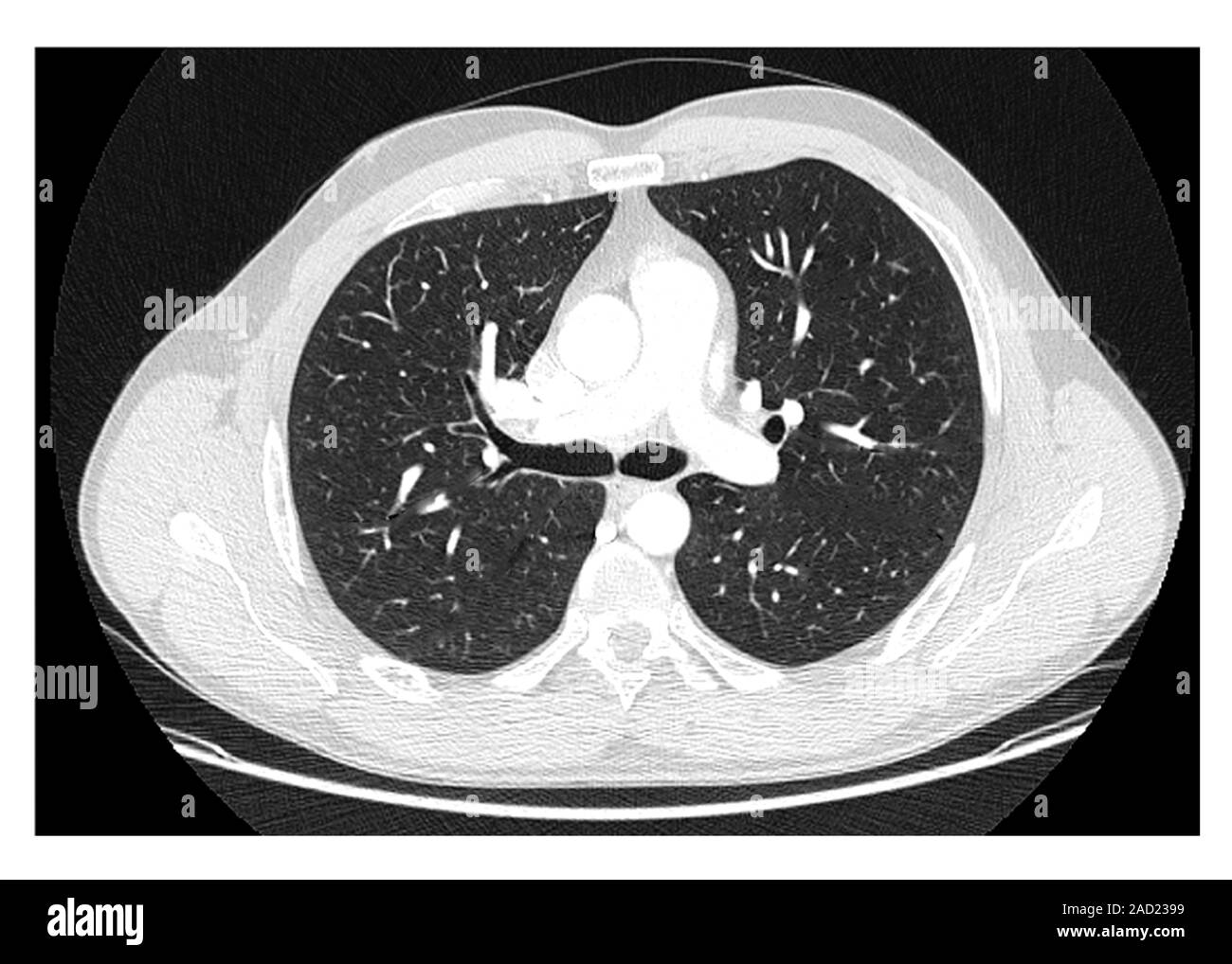 Illustration Of The Lungs Pulmonary Segmentation In Thoracic Ct This Illustration Is From