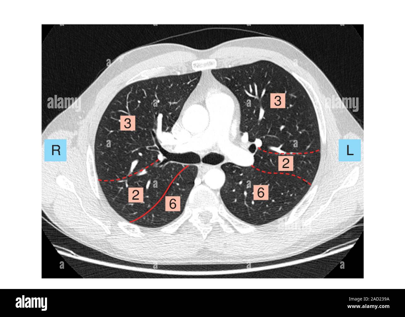 Illustration Of The Lungs Pulmonary Segmentation In Thoracic Ct This Image Labelled