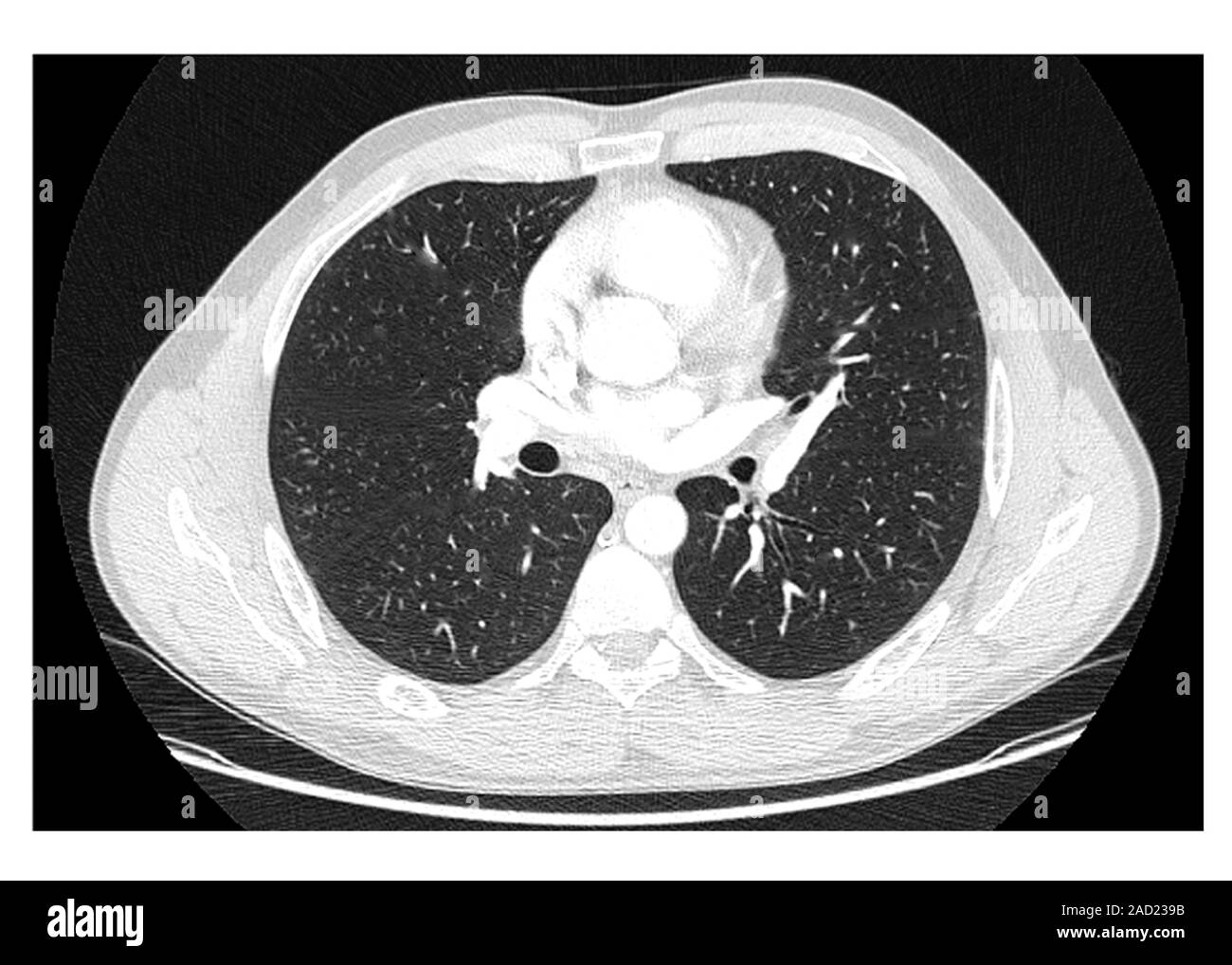 Illustration of the Lungs, Pulmonary segmentation in Thoracic CT. This ...