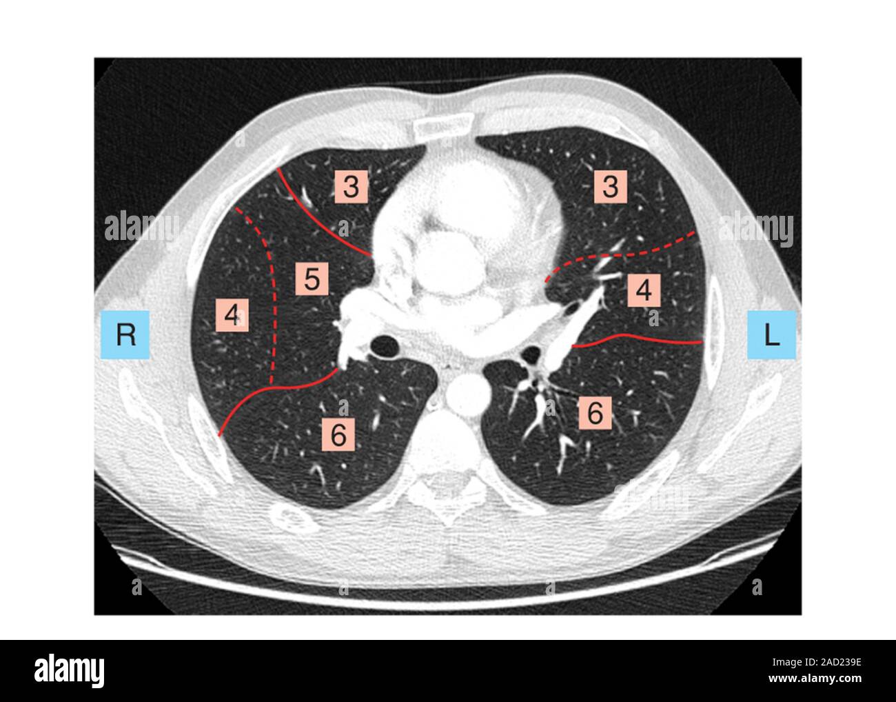 Illustration of the Lungs, Pulmonary segmentation in Thoracic CT. This ...
