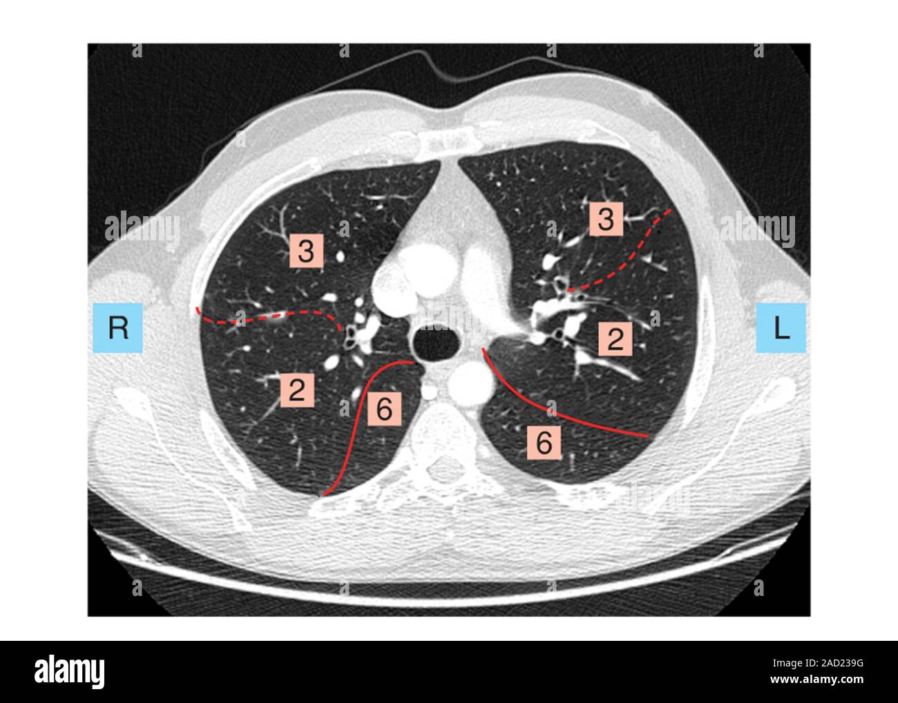 Illustration Of The Lungs Pulmonary Segmentation In Thoracic Ct This