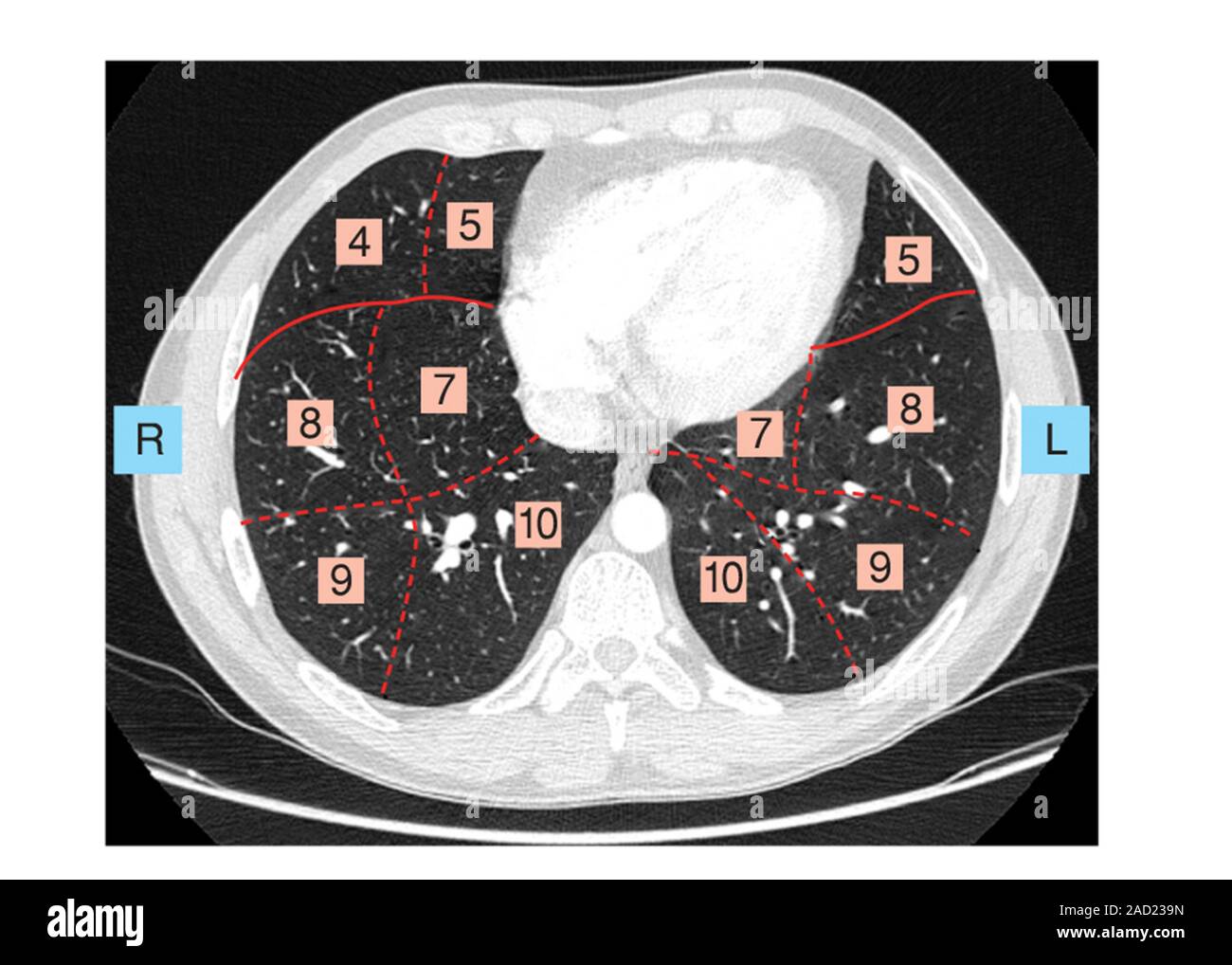 Illustration of the Lungs, Pulmonary segmentation in Thoracic CT. This ...
