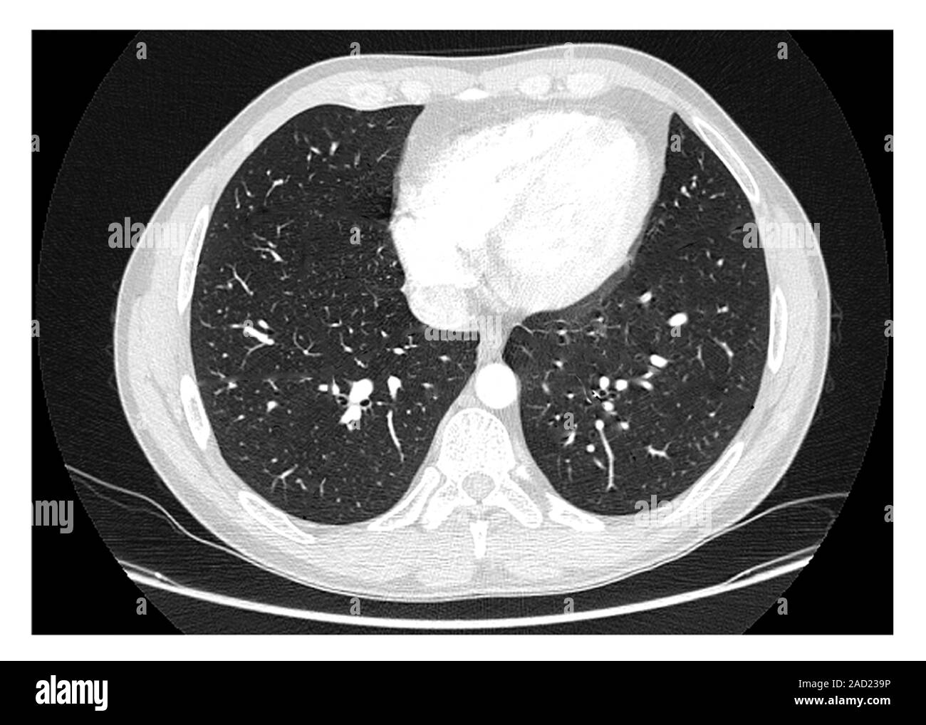 Illustration of the Lungs, Pulmonary segmentation in Thoracic CT. This ...