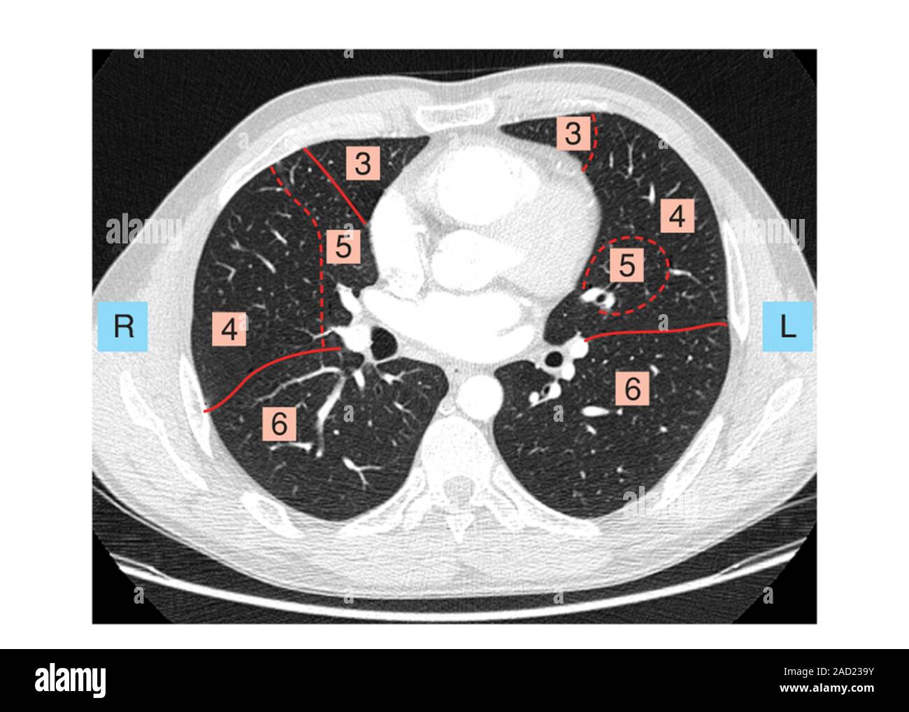 Illustration of the Lungs, Pulmonary segmentation in Thoracic CT. This ...