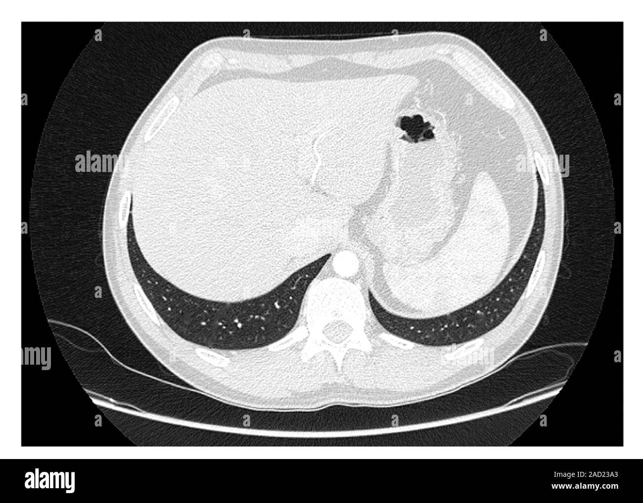 Illustration of the Lungs, Pulmonary segmentation in Thoracic CT. This ...