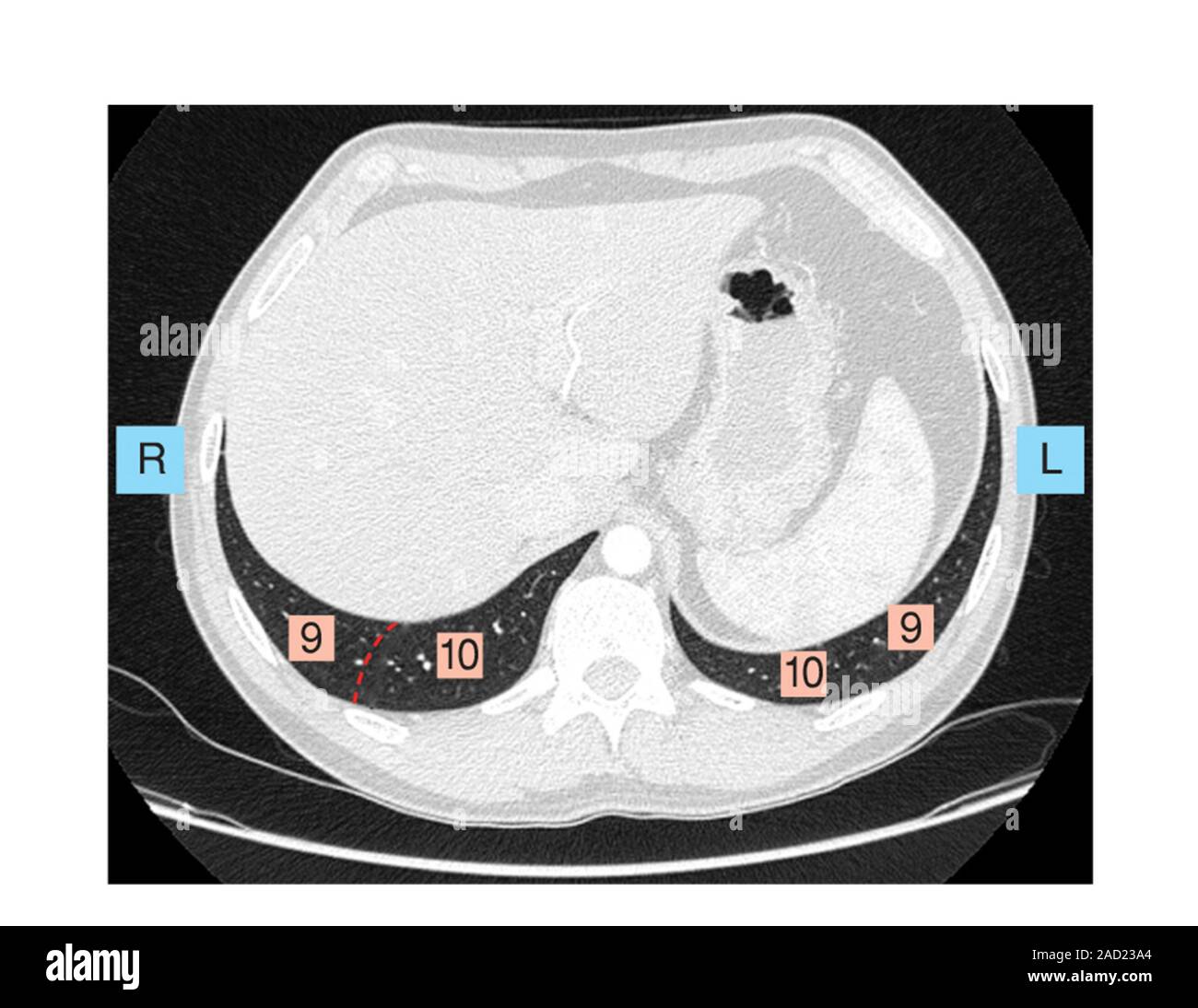 Illustration of the Lungs, Pulmonary segmentation in Thoracic CT. This ...