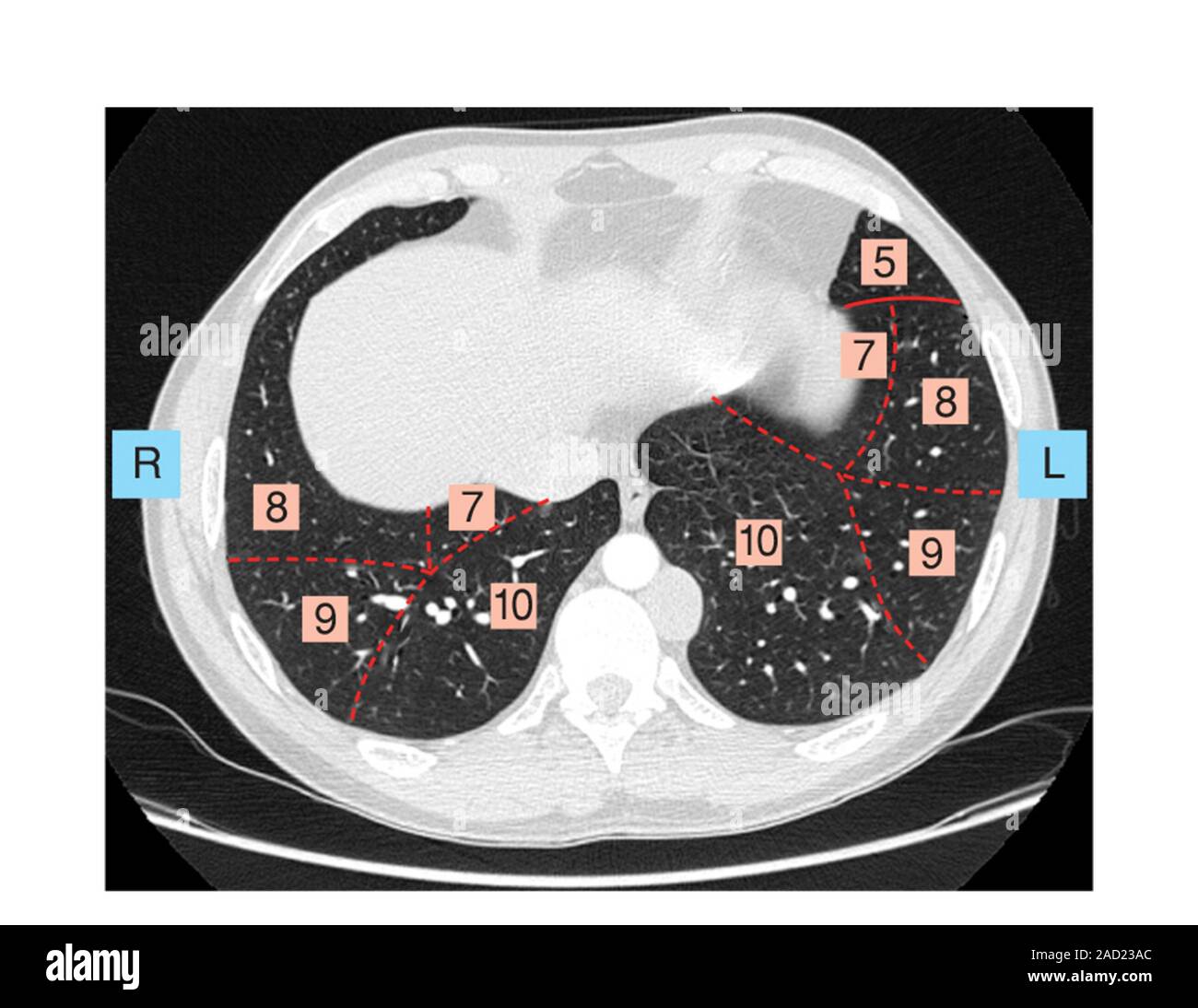 Illustration Of The Lungs Pulmonary Segmentation In Thoracic Ct This Image Labelled