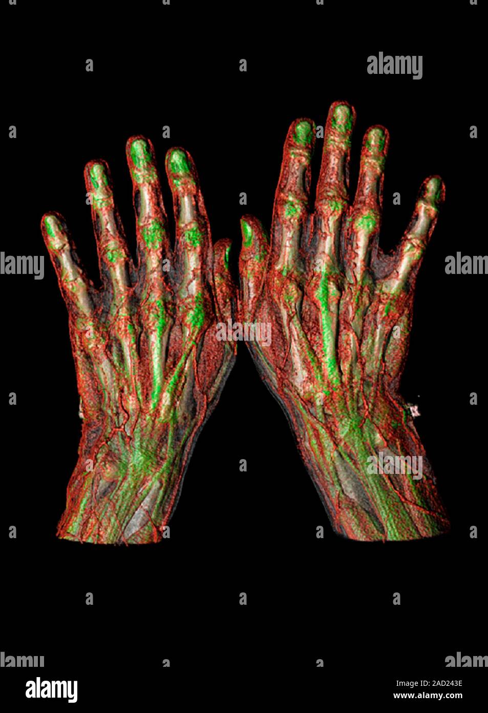 Human hands, dual-energy computed tomography (CT) scan. Tendons are ...