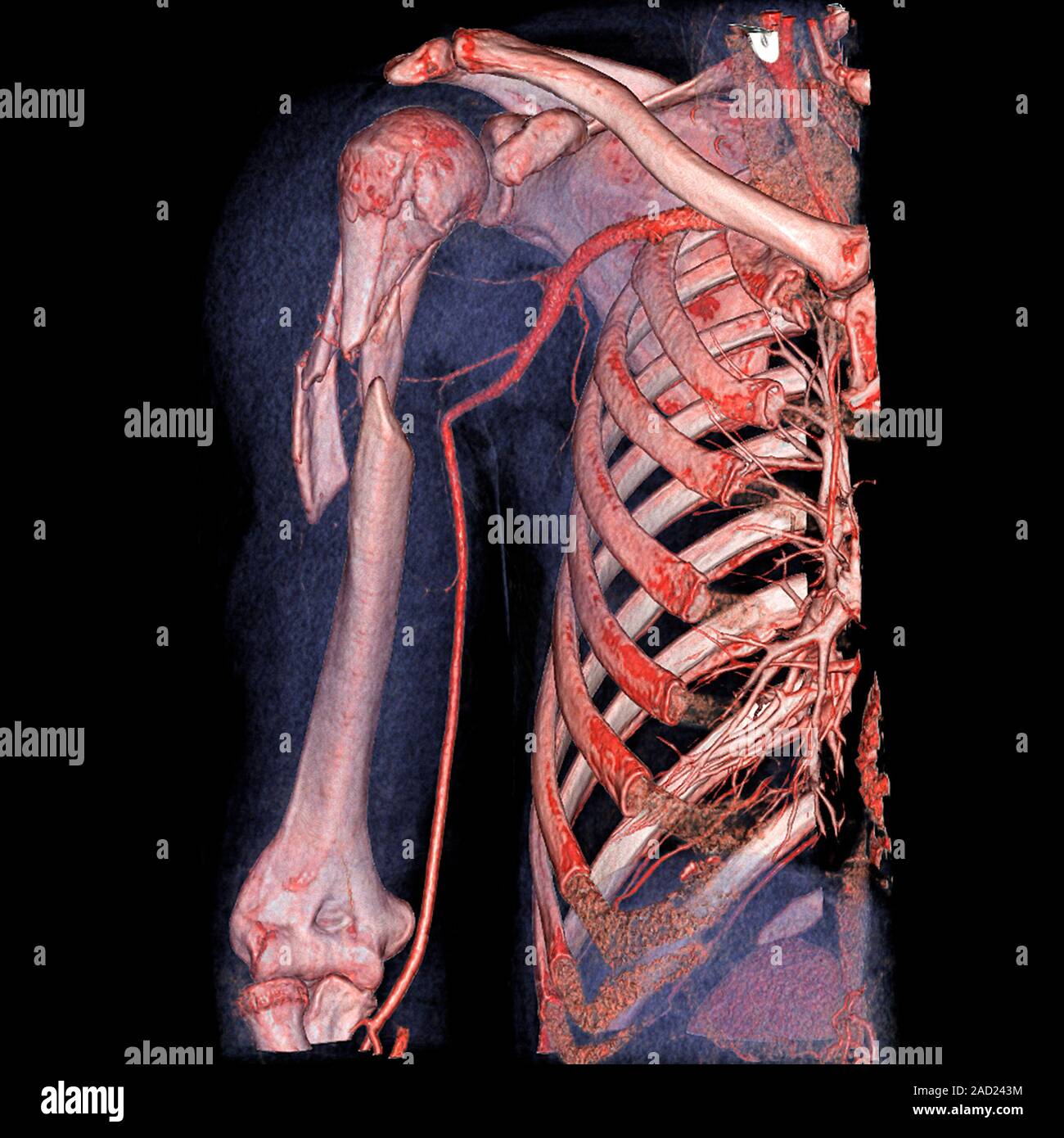 Broken upper arm bone, computed tomography (CT) scan Stock Photo - Alamy