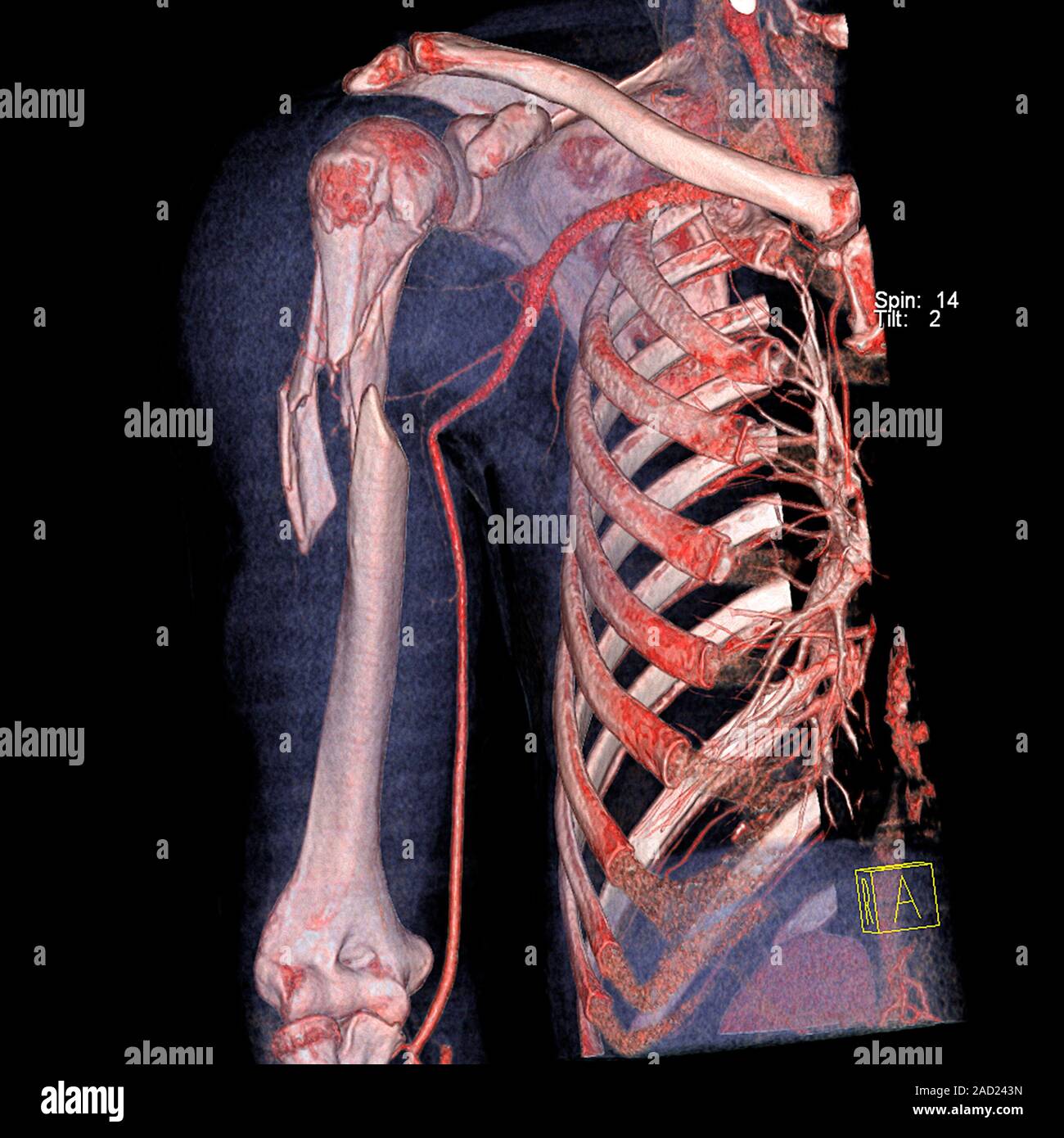 Broken upper arm bone, computed tomography (CT) scan Stock Photo - Alamy