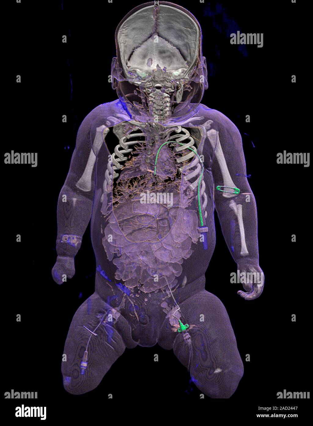 Human baby, computed tomography (CT) scan Stock Photo - Alamy