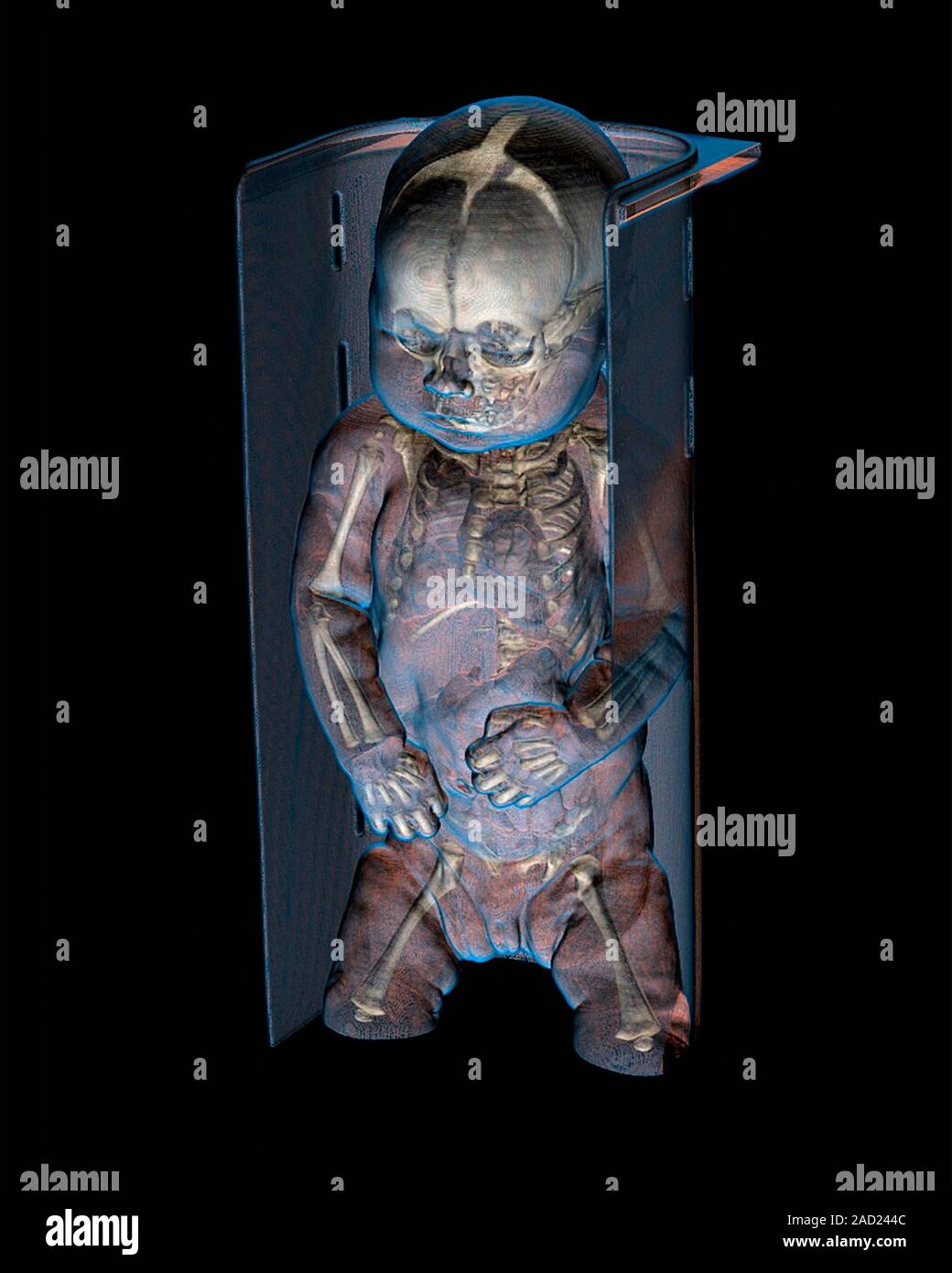 Human baby, computed tomography (CT) scan Stock Photo - Alamy