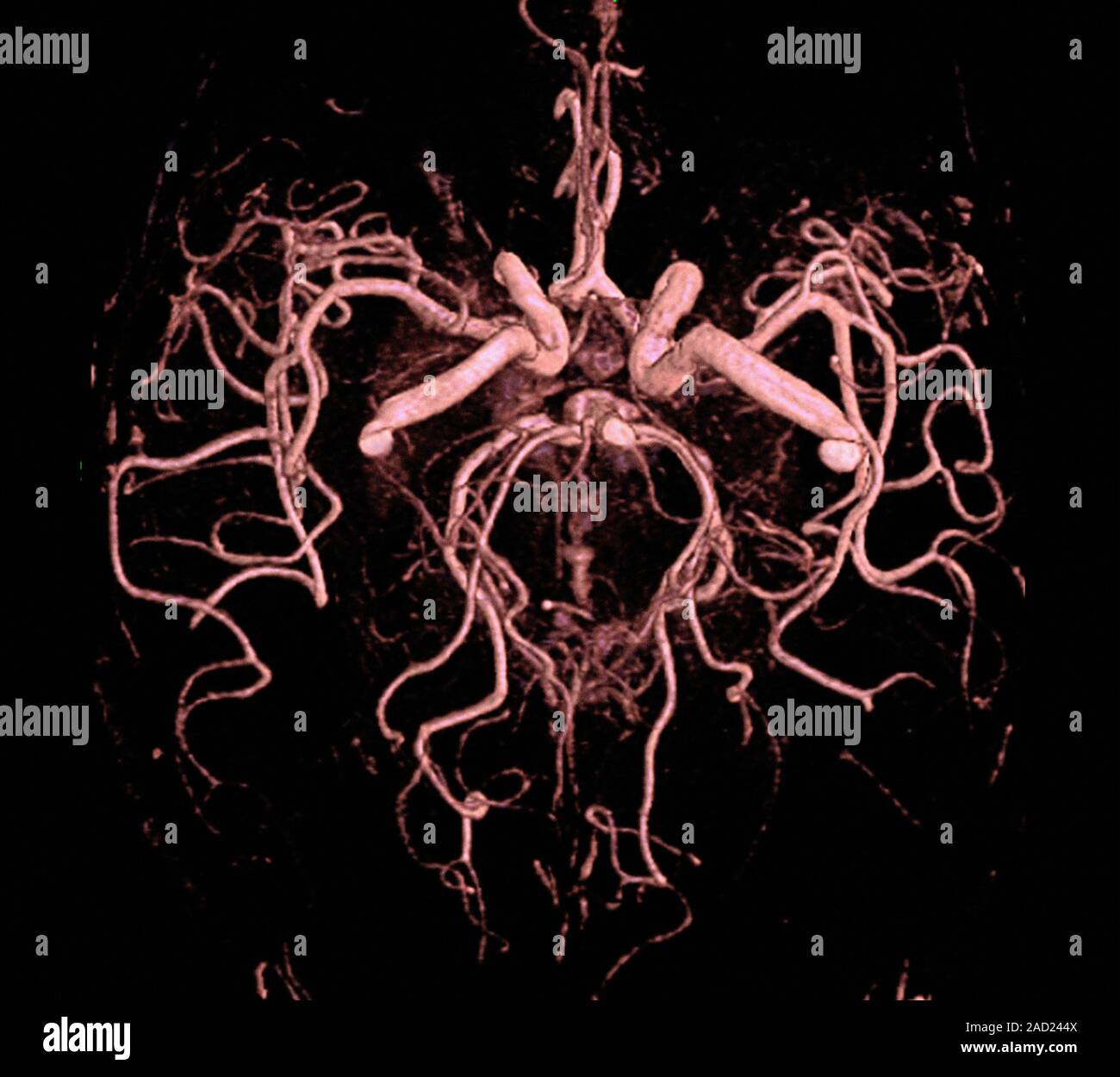 Brain arteries, magnetic resonance angiography (MRA). Cerebral arteries ...