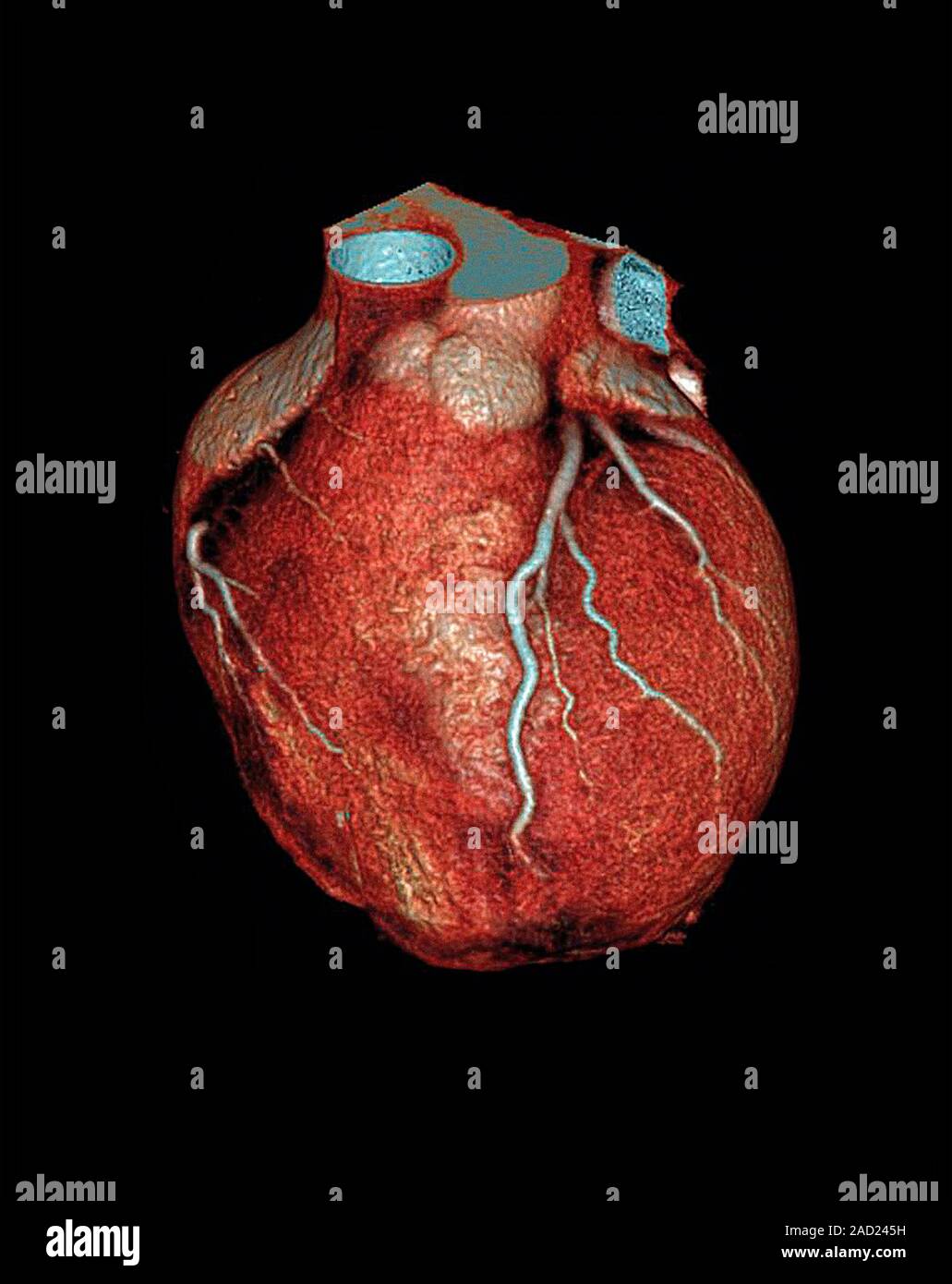 Human heart, computed tomography (CT) scan. The scan shows the heart's ...