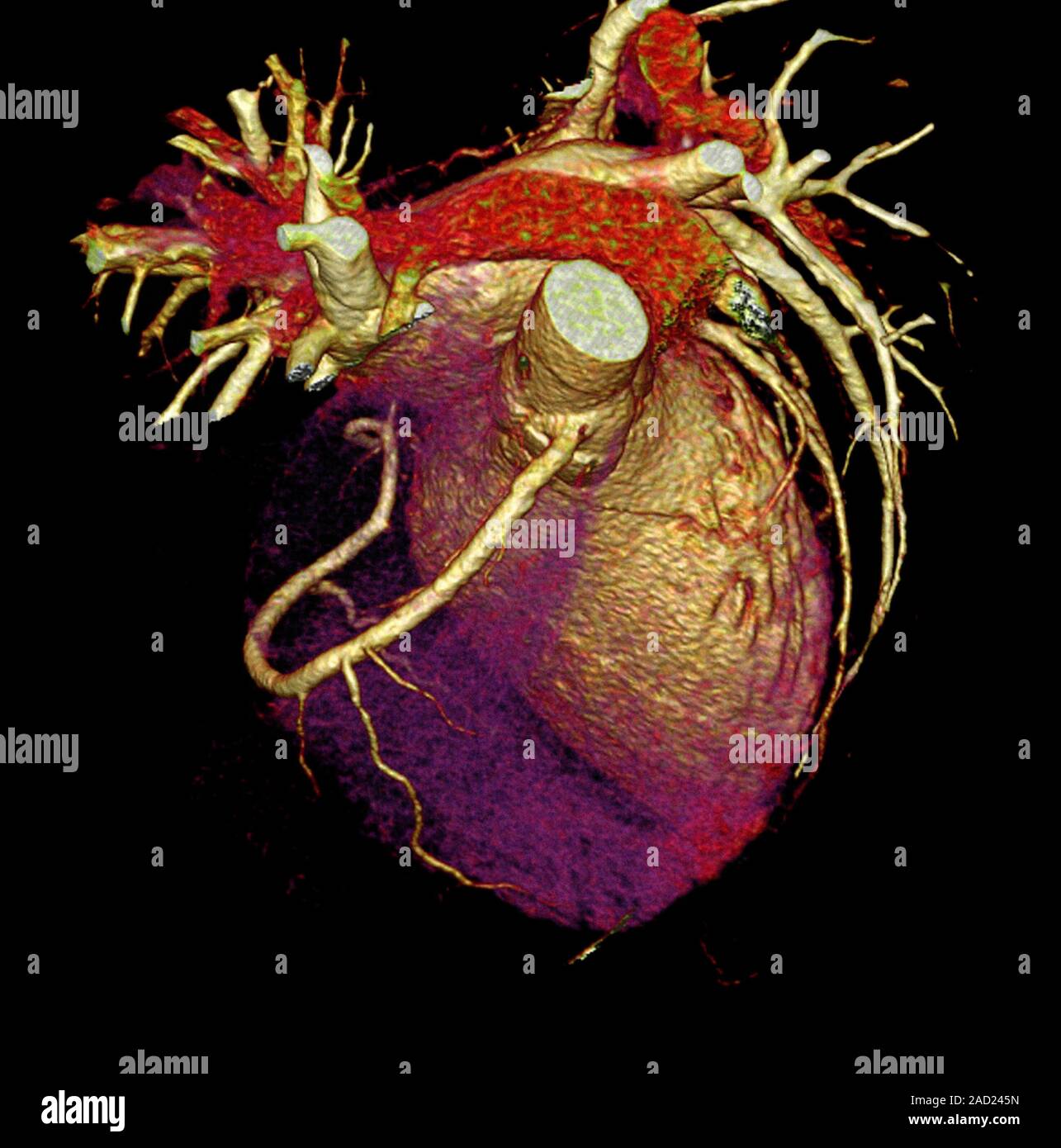 Human heart, computed tomography (CT) scan. The scan shows some of the ...