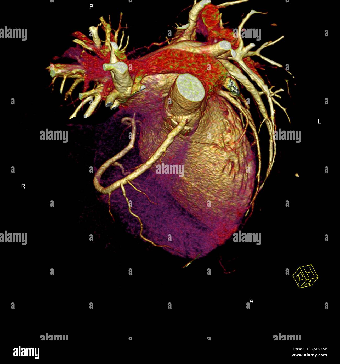 Human heart, computed tomography (CT) scan. The scan shows some of the ...